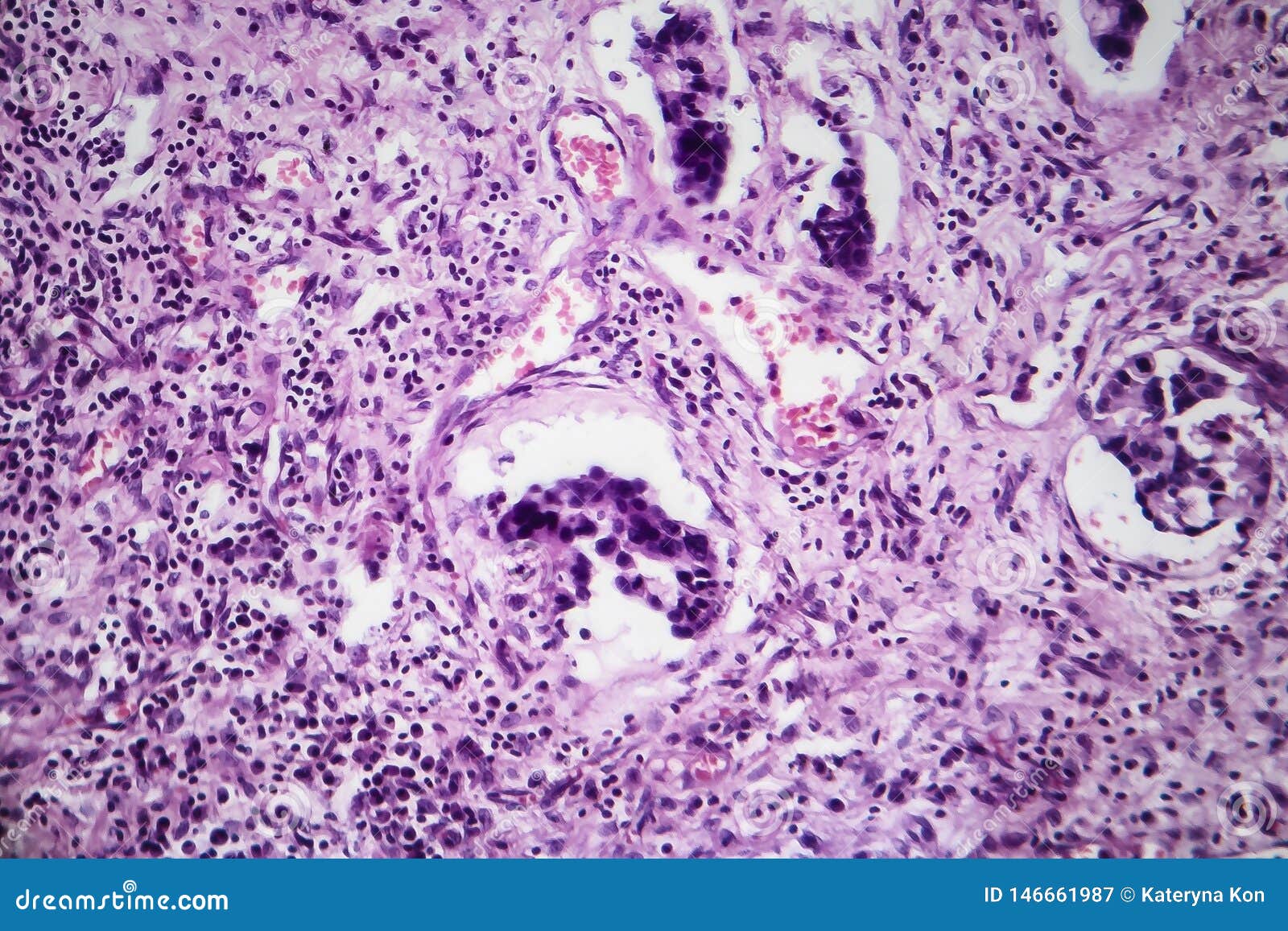 Gastric Adenocarcinoma, Light Micrograph Stock Illustration ...