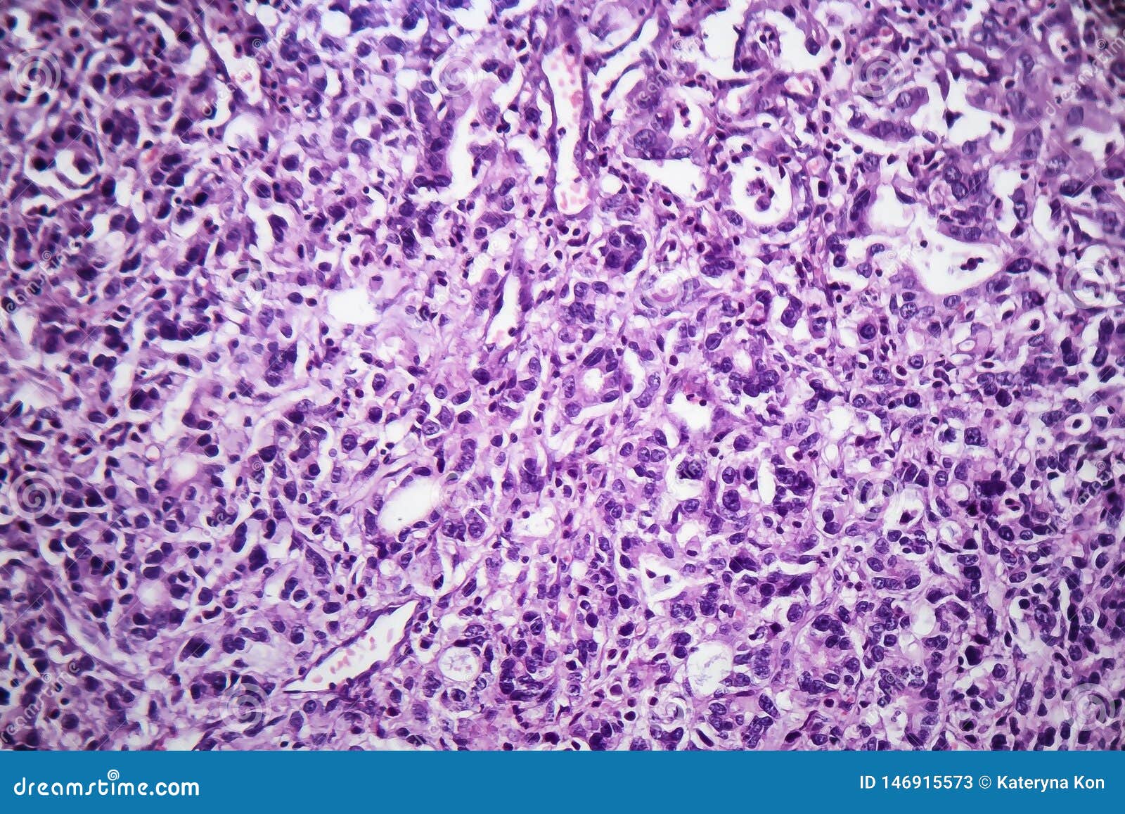 Gastric Adenocarcinoma, Light Micrograph Stock Image | CartoonDealer ...