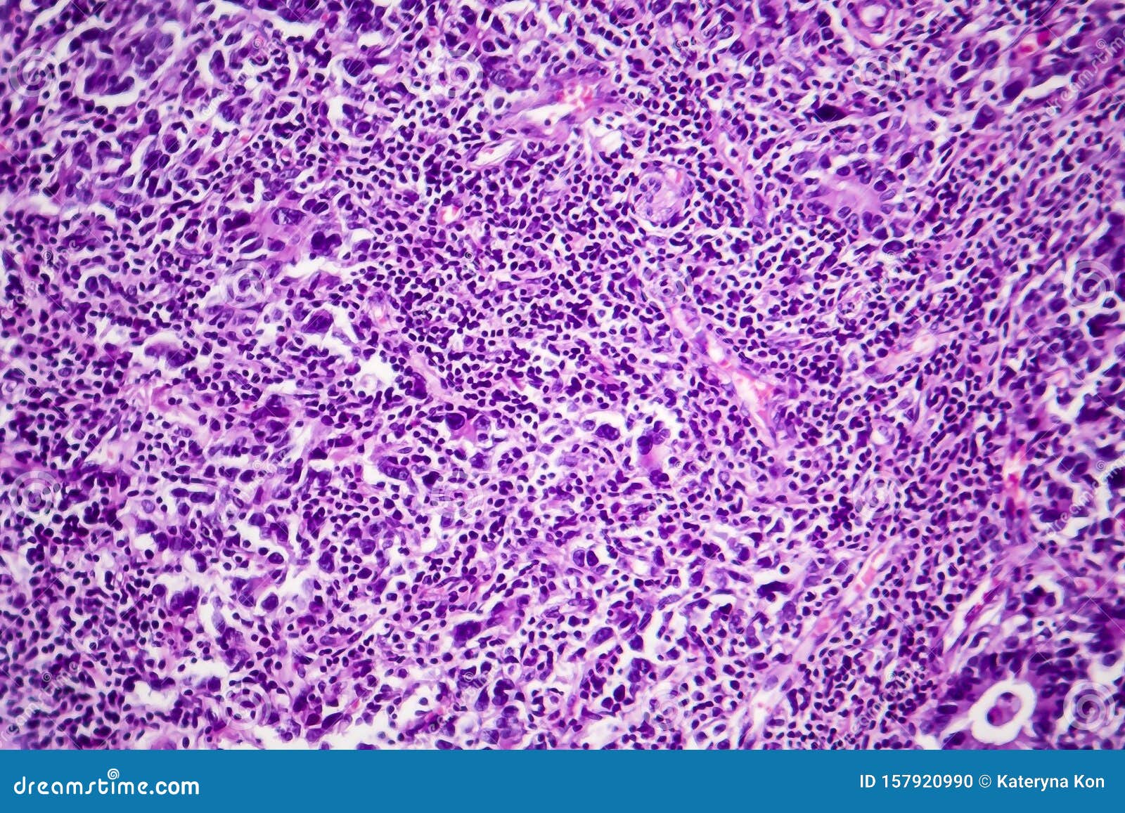 Gastric Adenocarcinoma, Light Micrograph Stock Photo - Image of eosin ...
