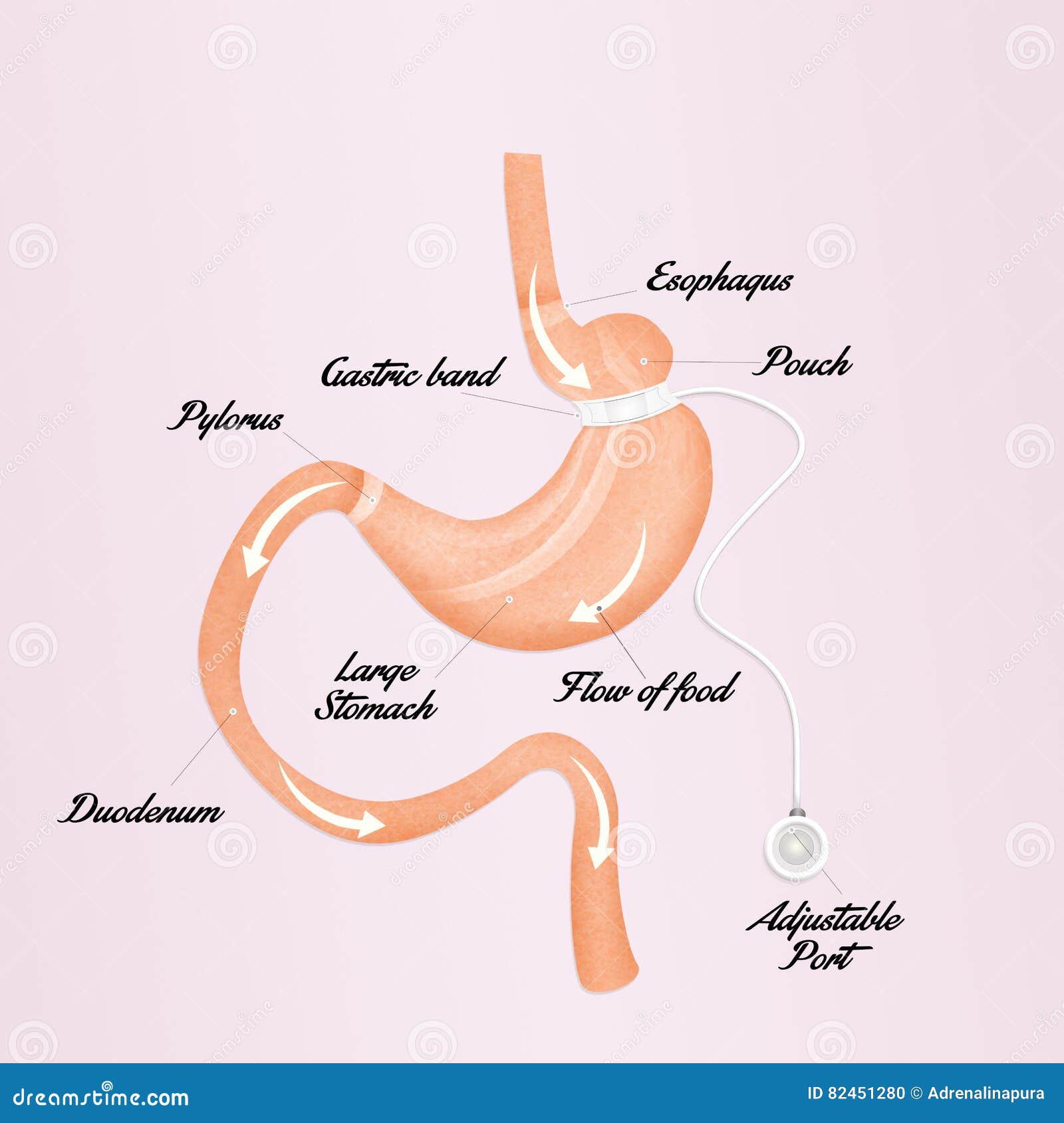 Gastric band stock illustration. Illustration of operation - 82451280