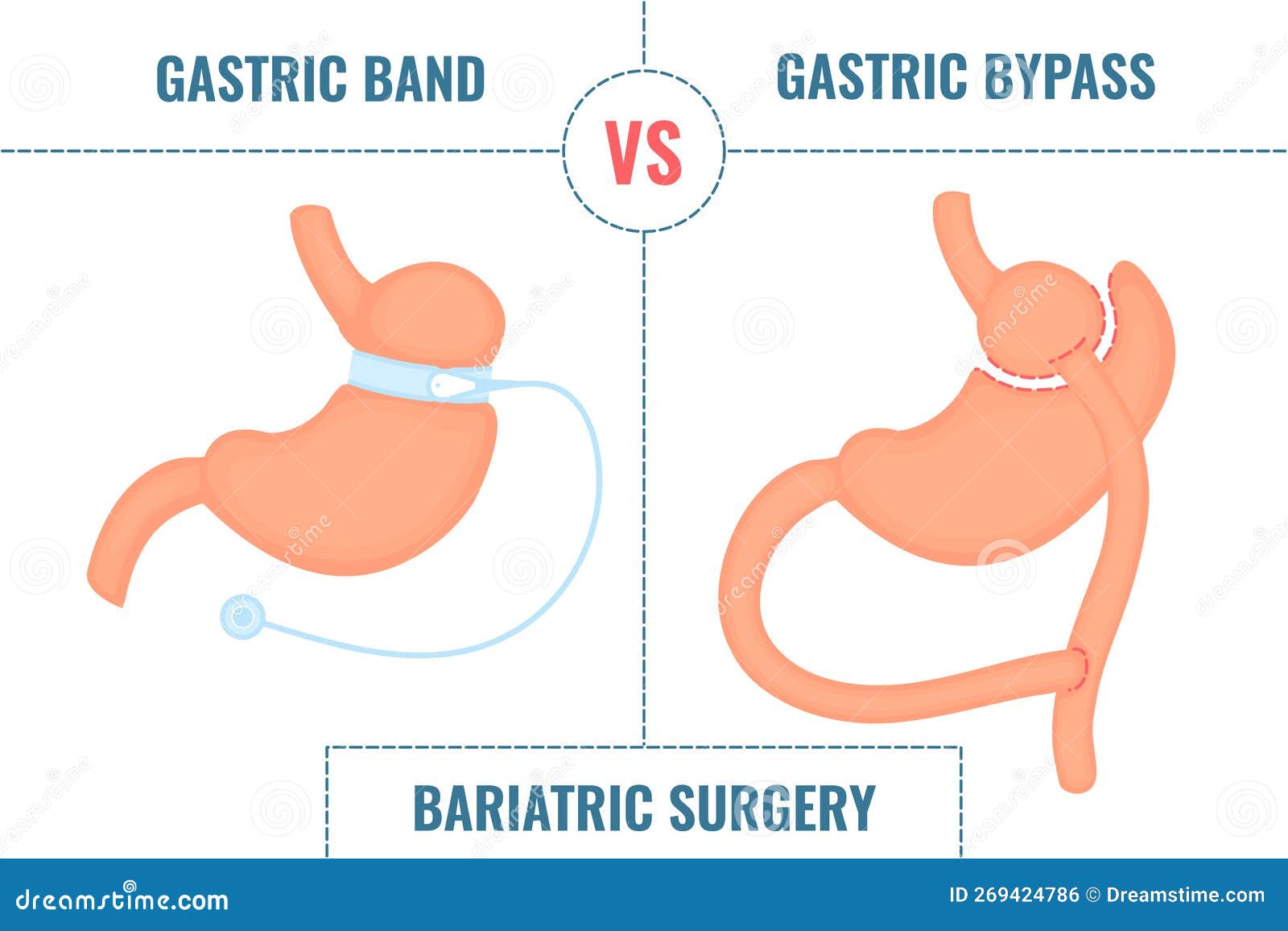 Gastric Band Vs Gastric Bypass Bariatric Surgery Weight Loss ... Gastric Band Vs Gastric Bypass Bariatric Surgery Weight Loss ...