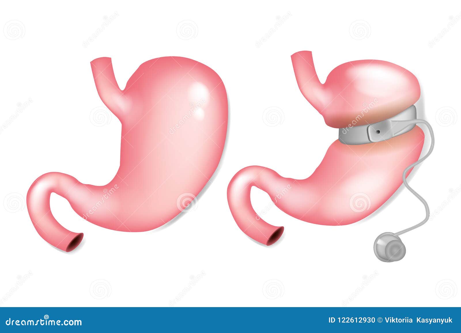 Gastric Banding Surgery stock vector. Illustration of digestion - 122612930