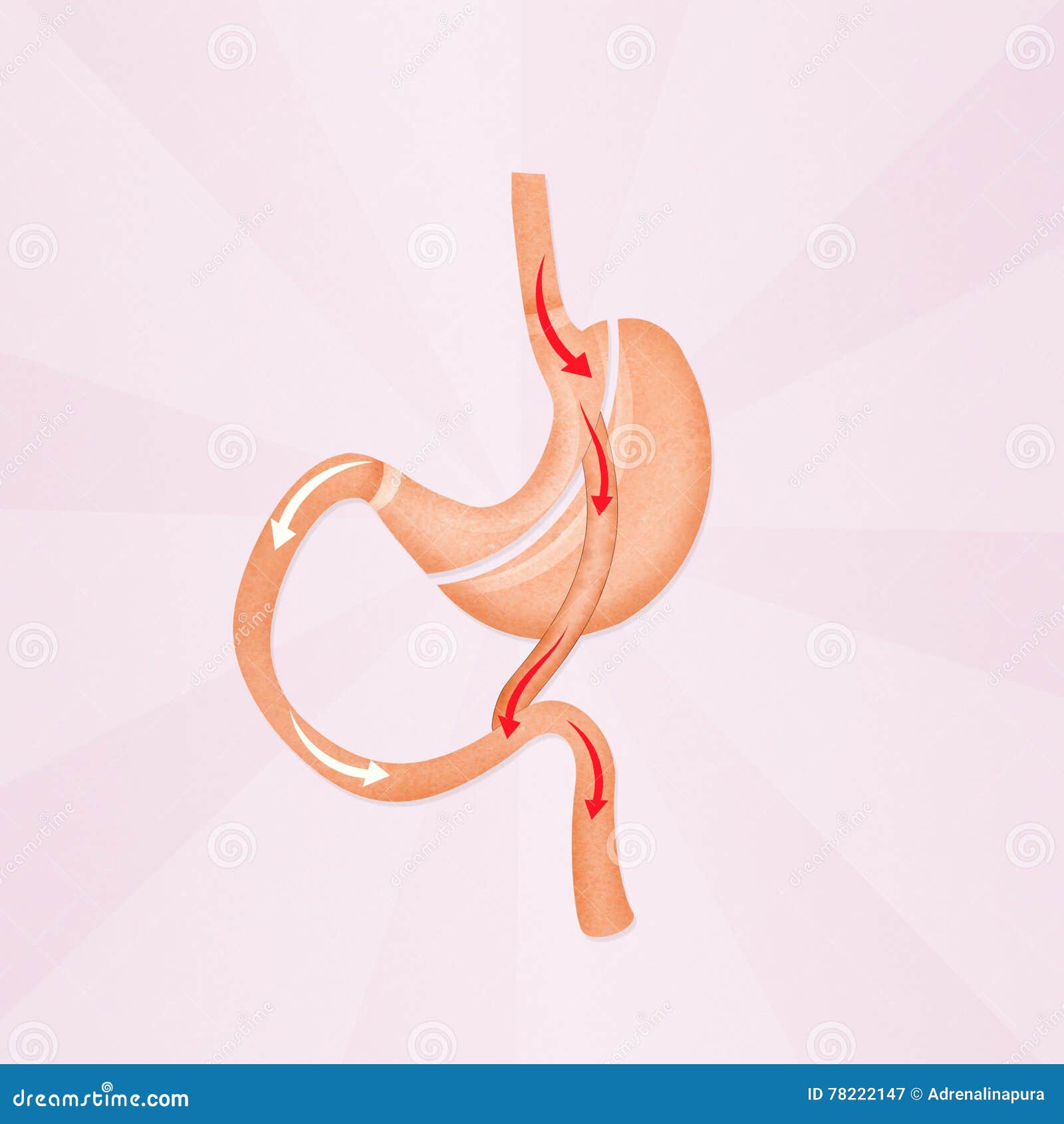 Gastric Bypass Logo Roux-en-Y (RNY) Weight Loss Surgery Logo Vector ...