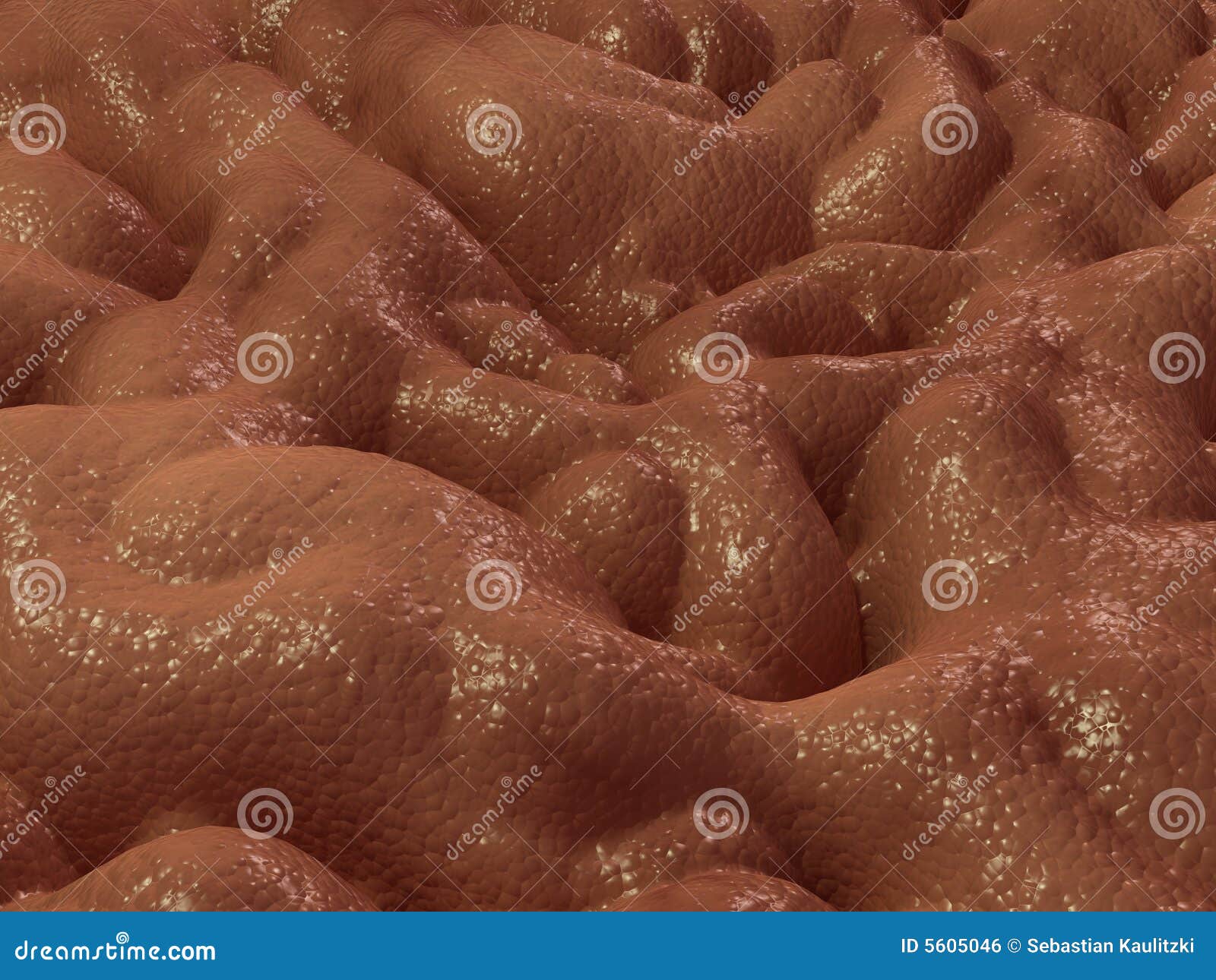 Gastric Mucosa In Polypous Gastritis. Infographics. Vector Illustration ...