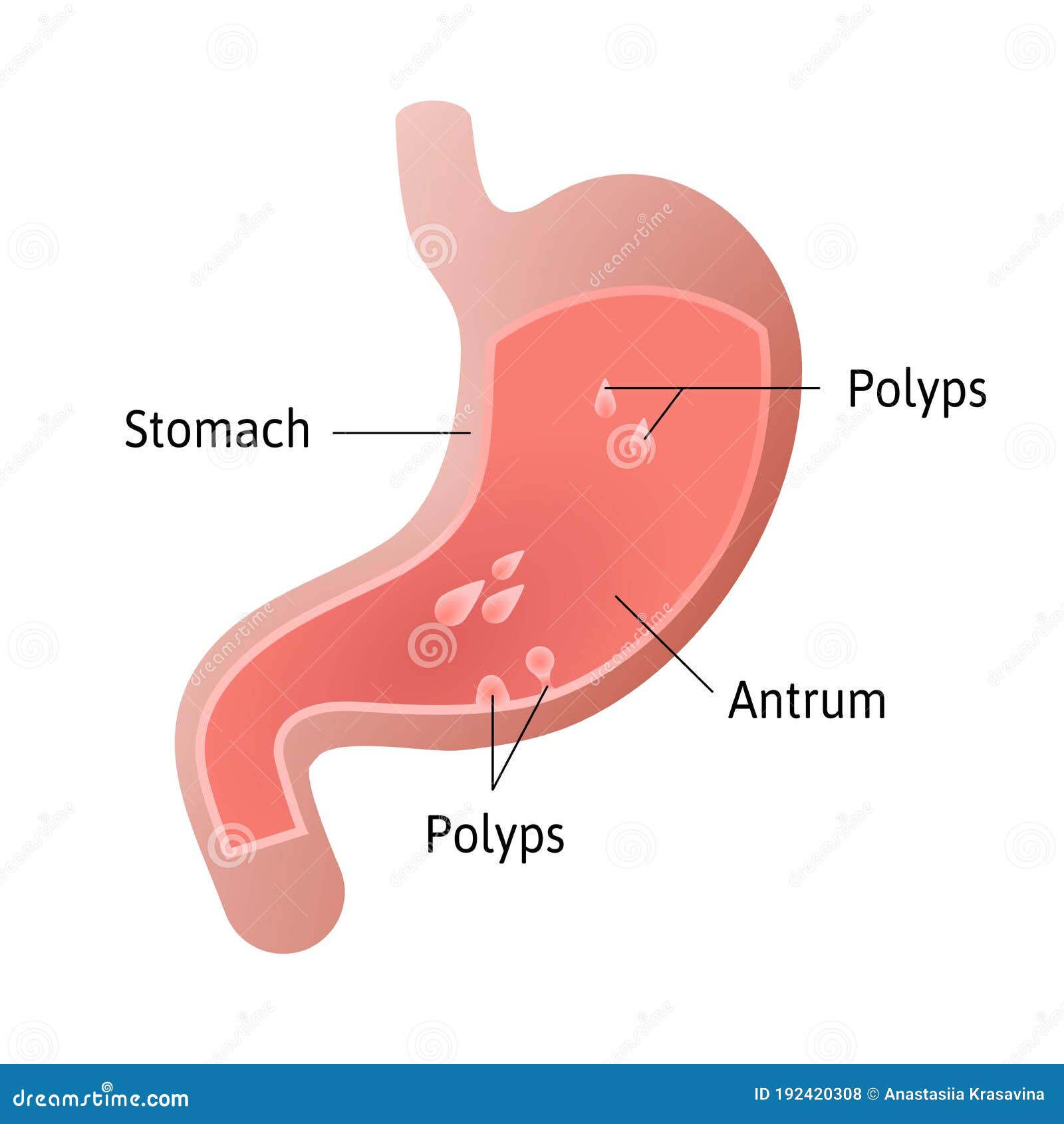 Gastric Polyps Masses Of Cells That Form On The Lining Inside Stomach Pedunculated And Flat
