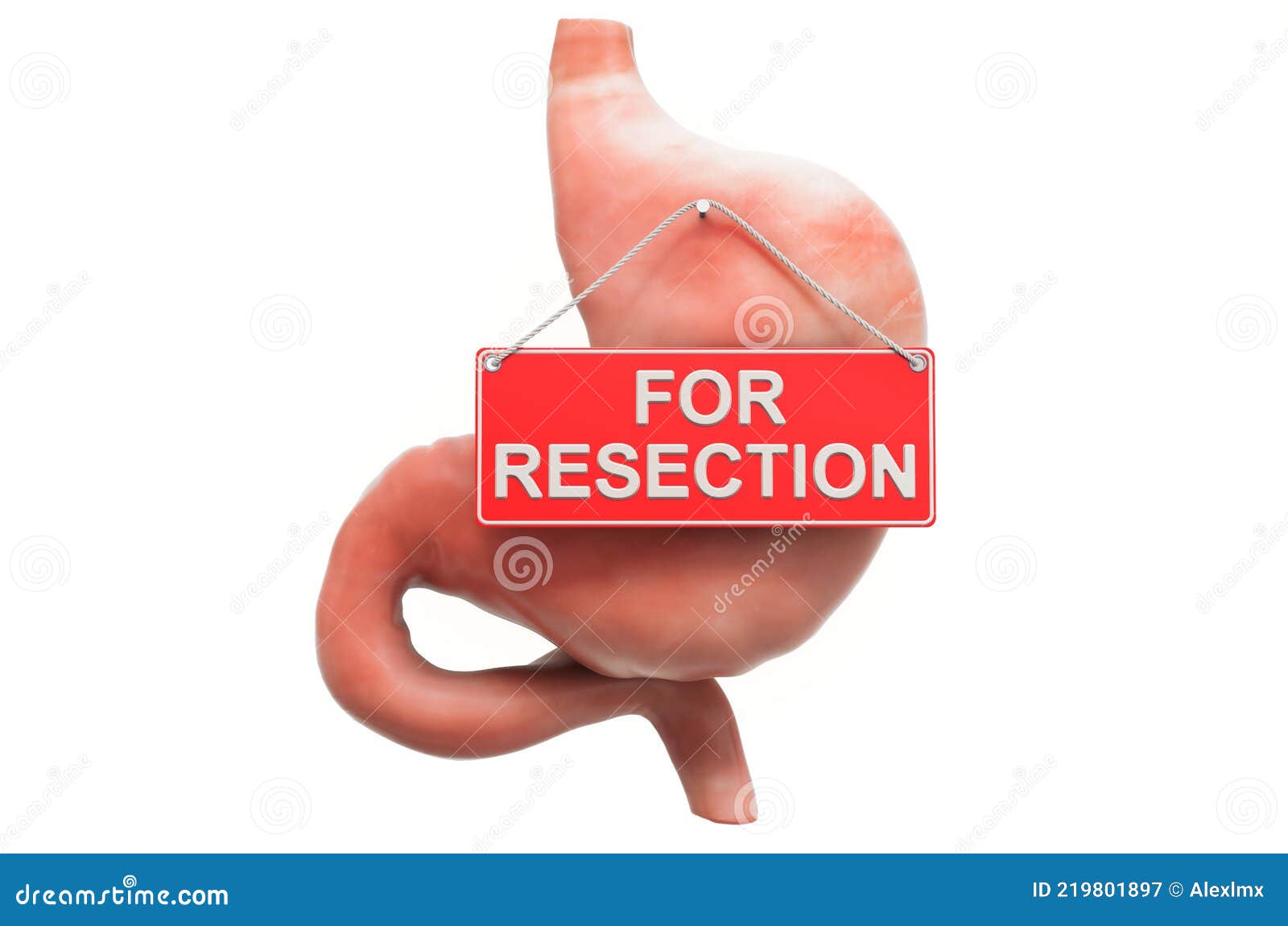 Gastric Resection Concept. Human Stomach With For Resection Hanging ...