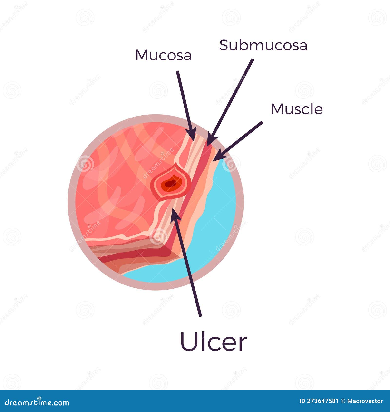 Gastric Ulcer Illustration Cartoon Vector | CartoonDealer.com #273647581