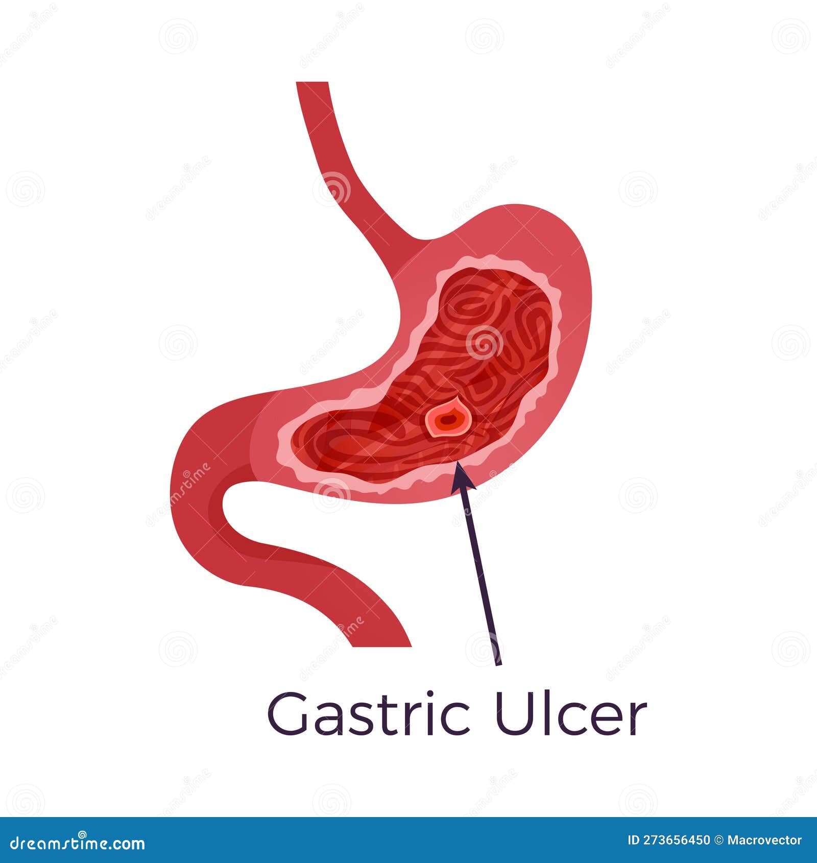 Gastric Ulcer Illustration stock vector. Illustration of tissue - 273656450
