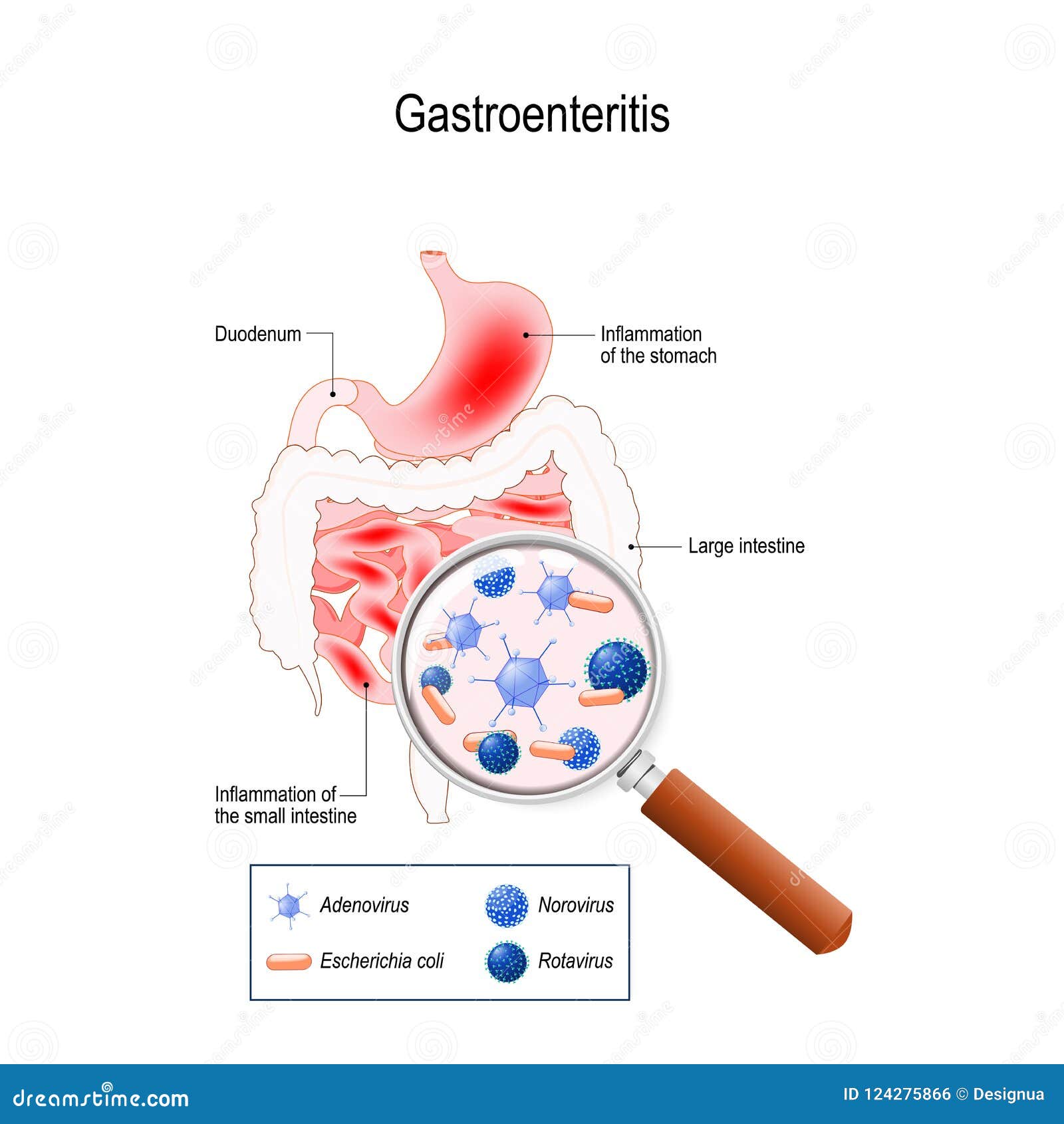 Gastroenterite ilustração do vetor. Ilustração de corpo - 124275866