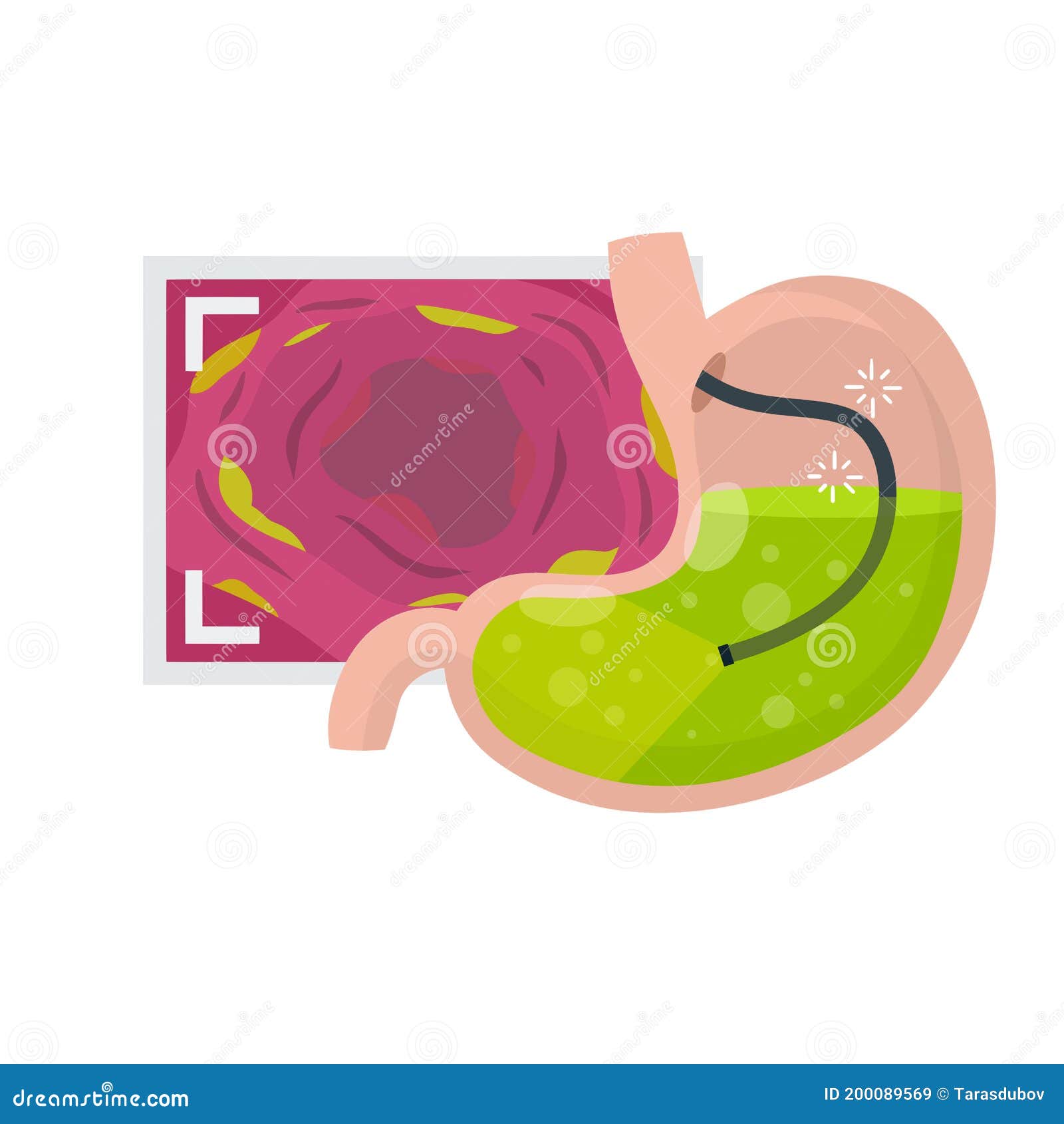 Gastroscopy. Endoscopy and Digestive Problems Stock Vector ...