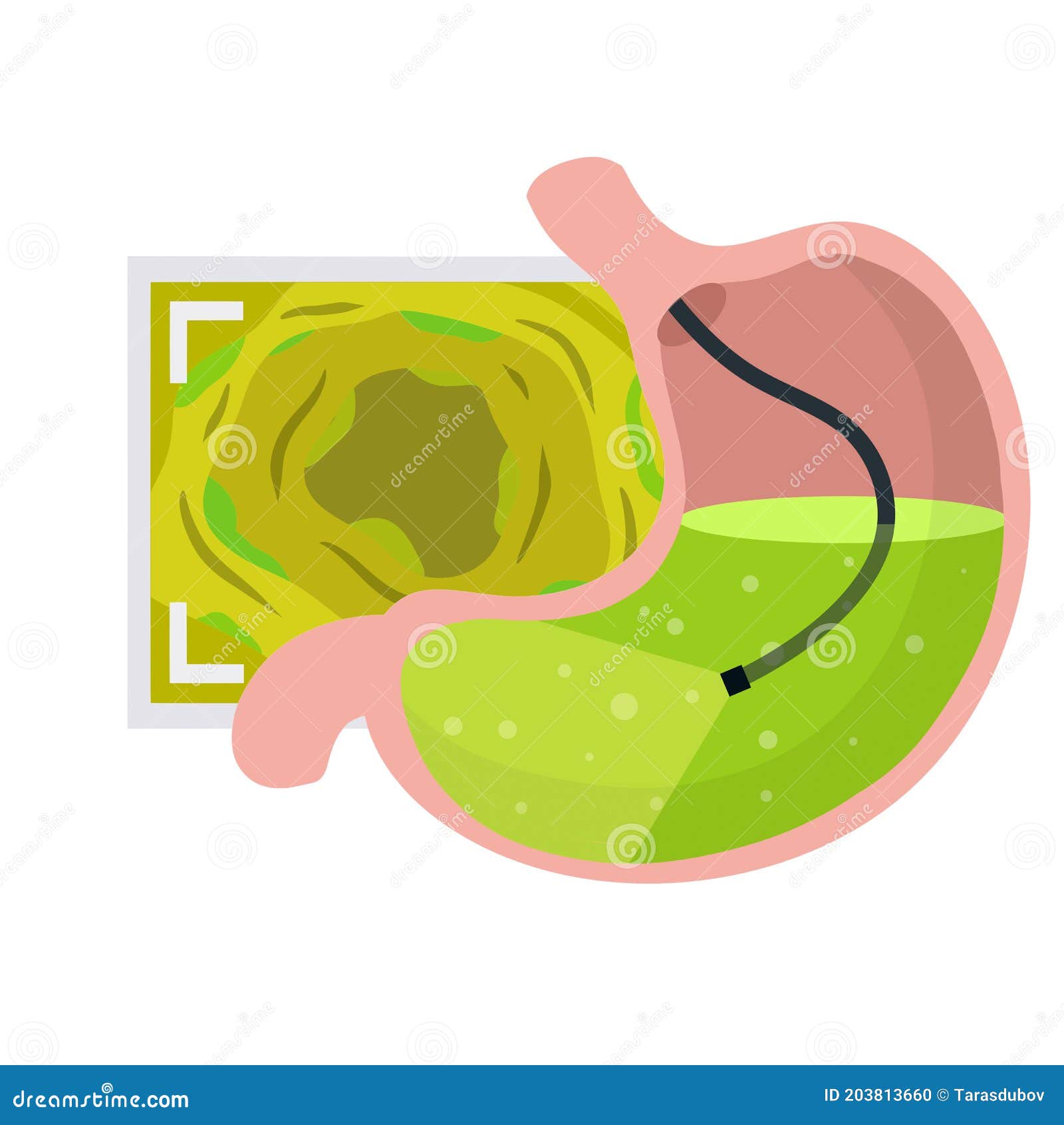 Gastroscopy Endoscopy Procedure Cartoon Vector | CartoonDealer.com ...