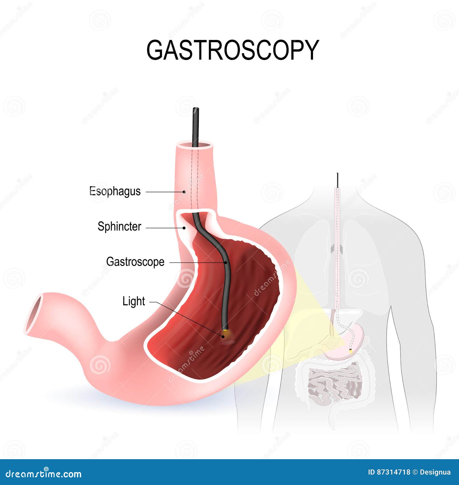 Gastroscopy, Esofagoscopia Y Duodenoscopy Ilustración del Vector ...