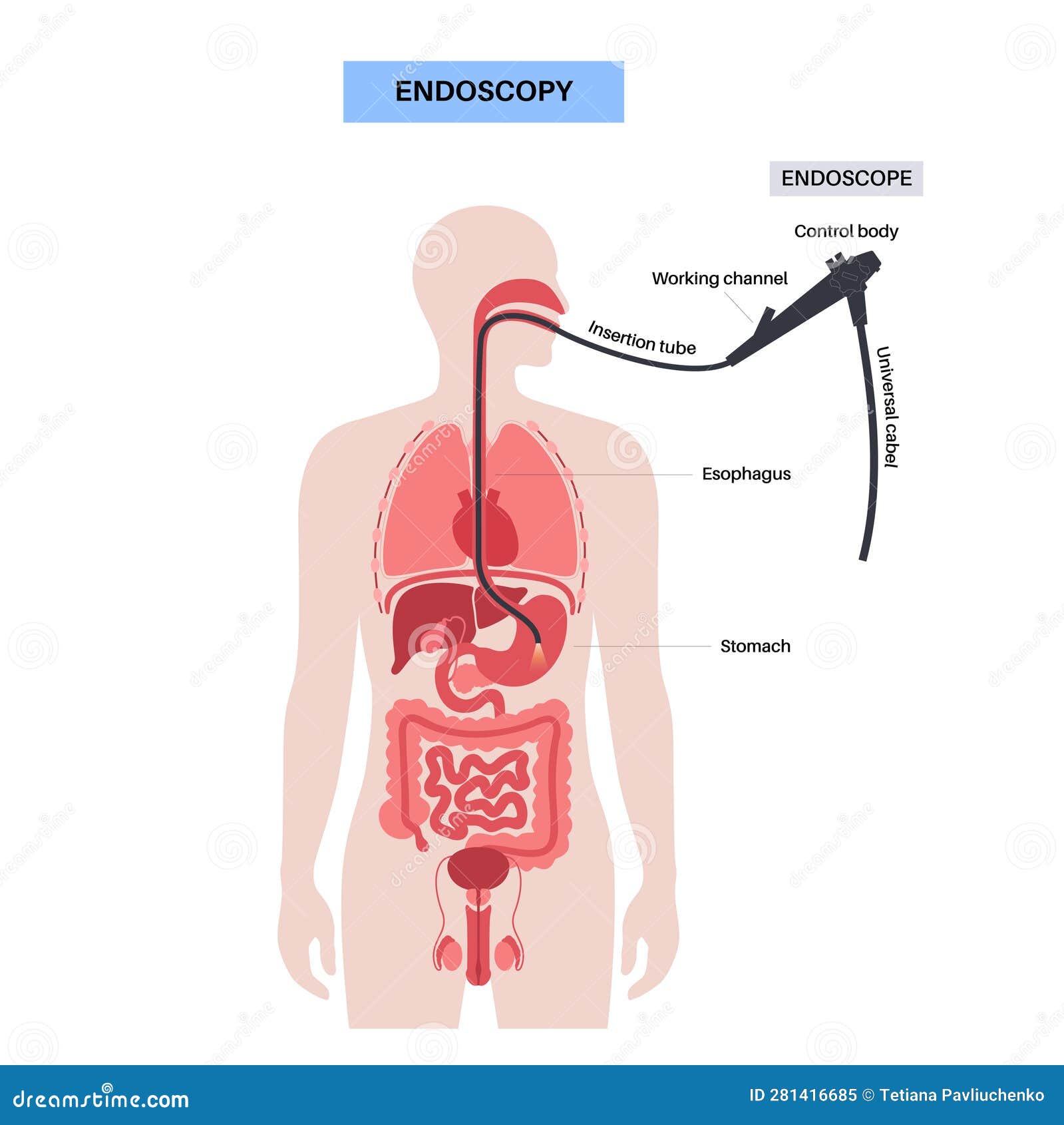 Gastroscopy Endoscopy Procedure Stock Vector Illustration Of Gastric