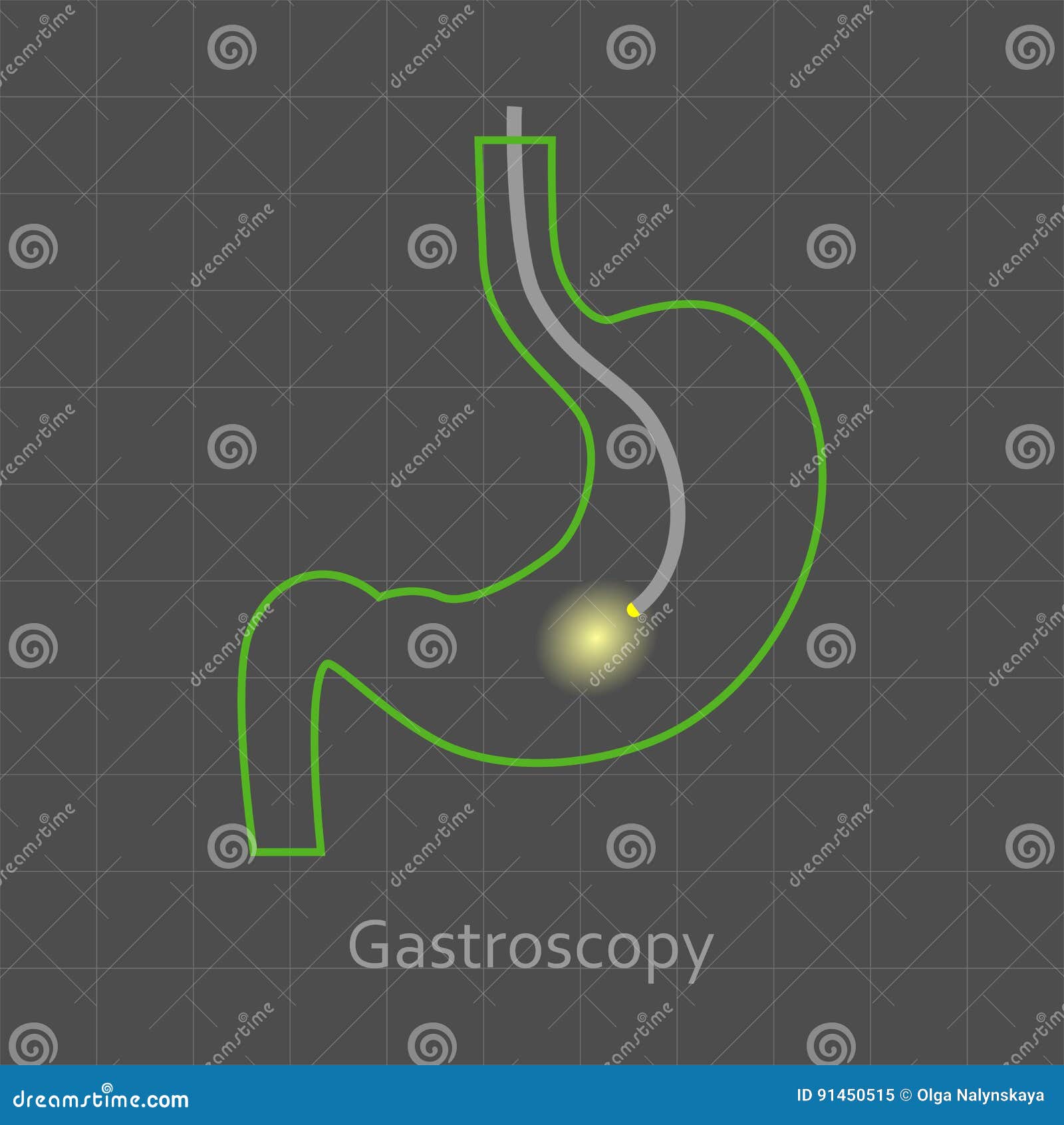 Gastroscopy Procedure. Human Stomach With Peptic Ulcer, And Endoscopic ...
