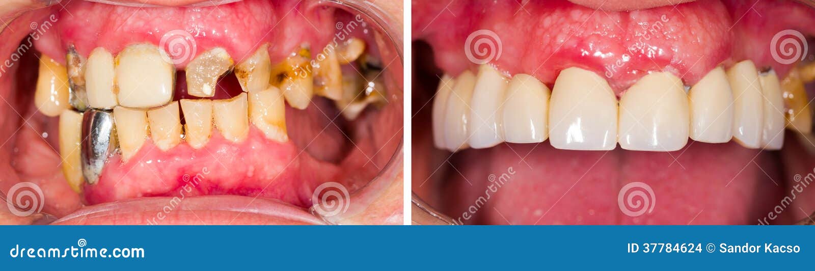 Gebit before and after Behandeling Stock Foto - Image of bederf ...