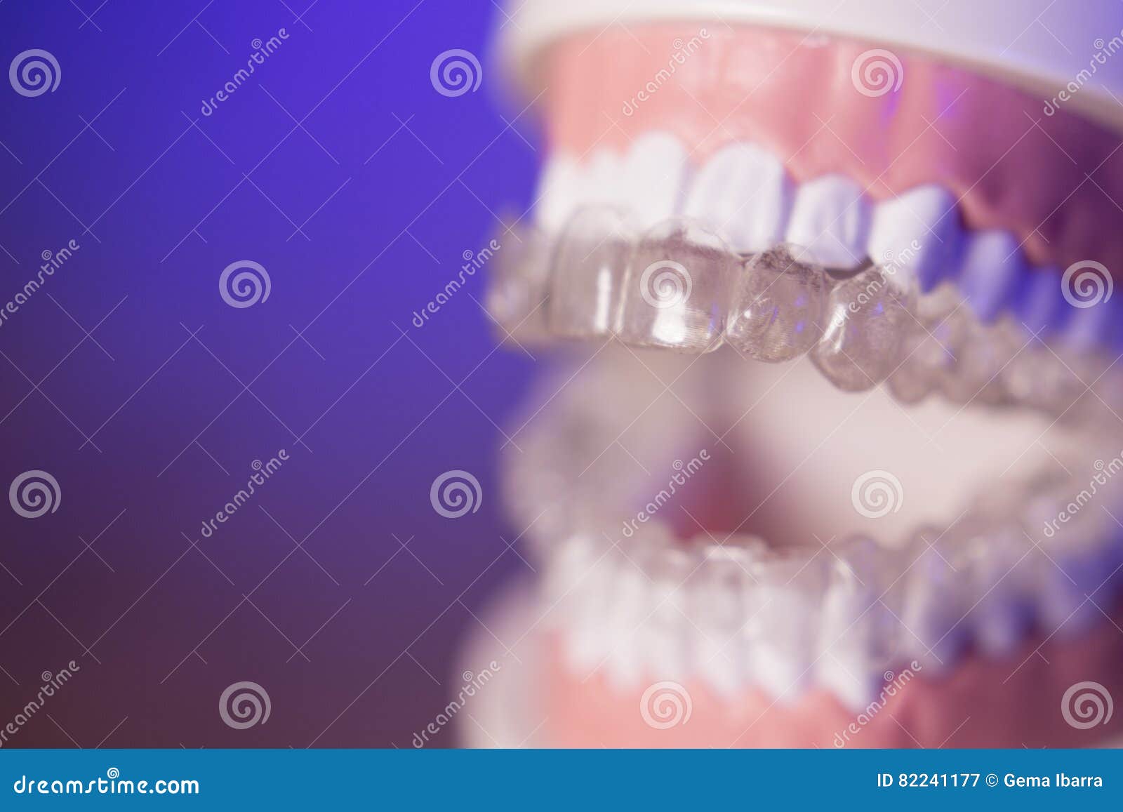 Gebit Met Transparante Orthodontie Stock Afbeelding - Image of ...