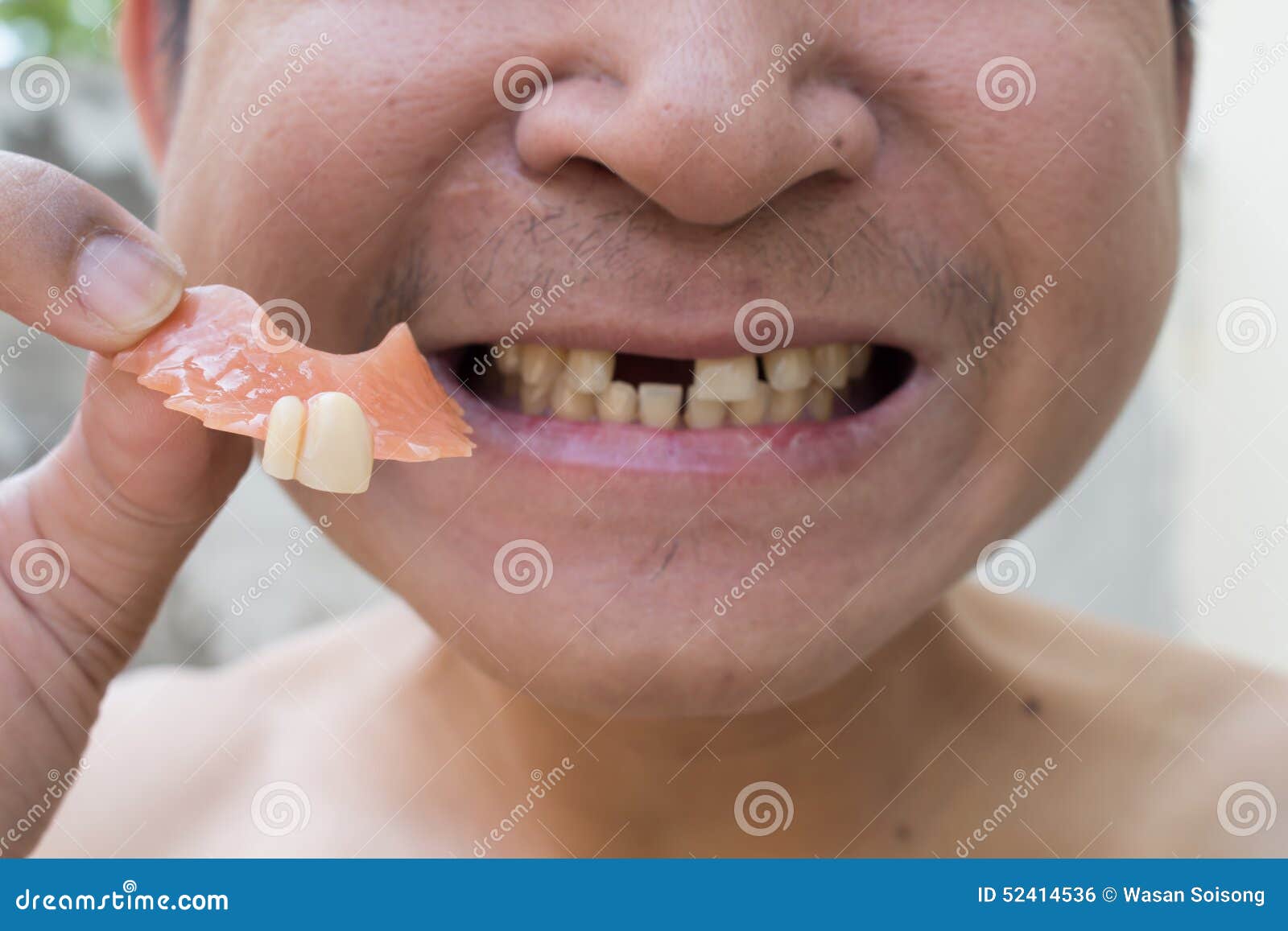 Gebit Van Een Mens Gebroken Tand Stock Foto - Image of vuist, begrip ...