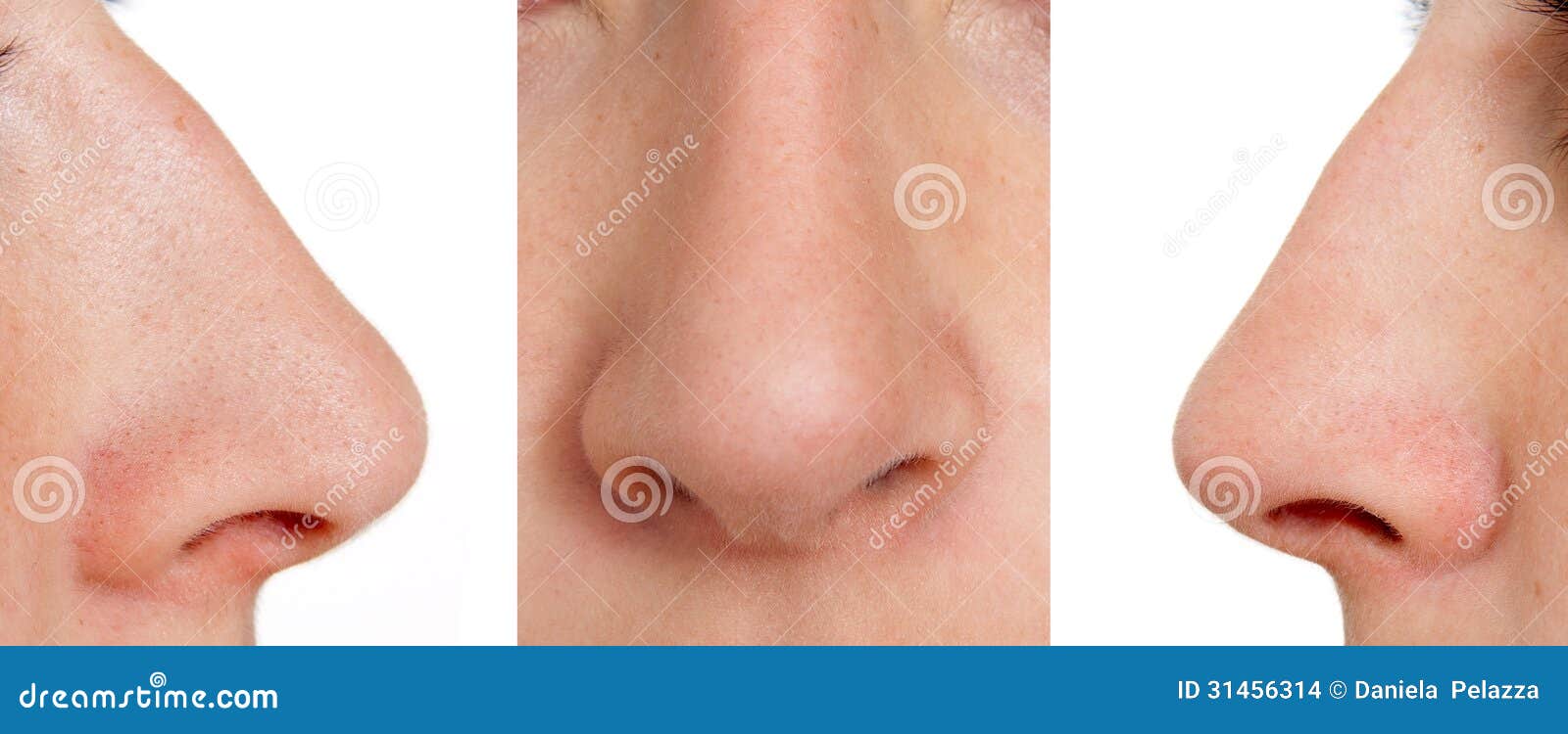 Gebogene Nase stockfoto. Bild von recht, medizinisch - 31456314