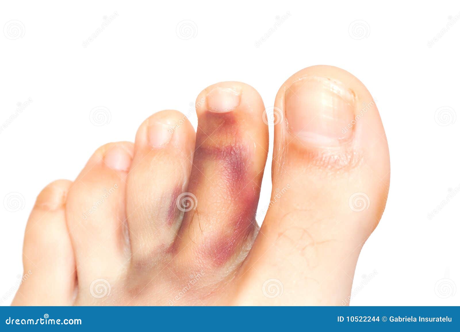 Gebrochene Zehe stockfoto. Bild von verbindung, geschwollen - 10522244