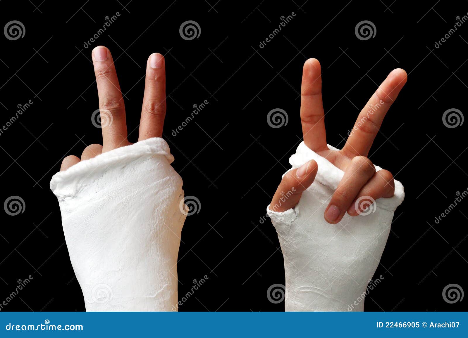 Gebrochener Arm - 01 stockbild. Bild von unfall, schmerz - 22466905