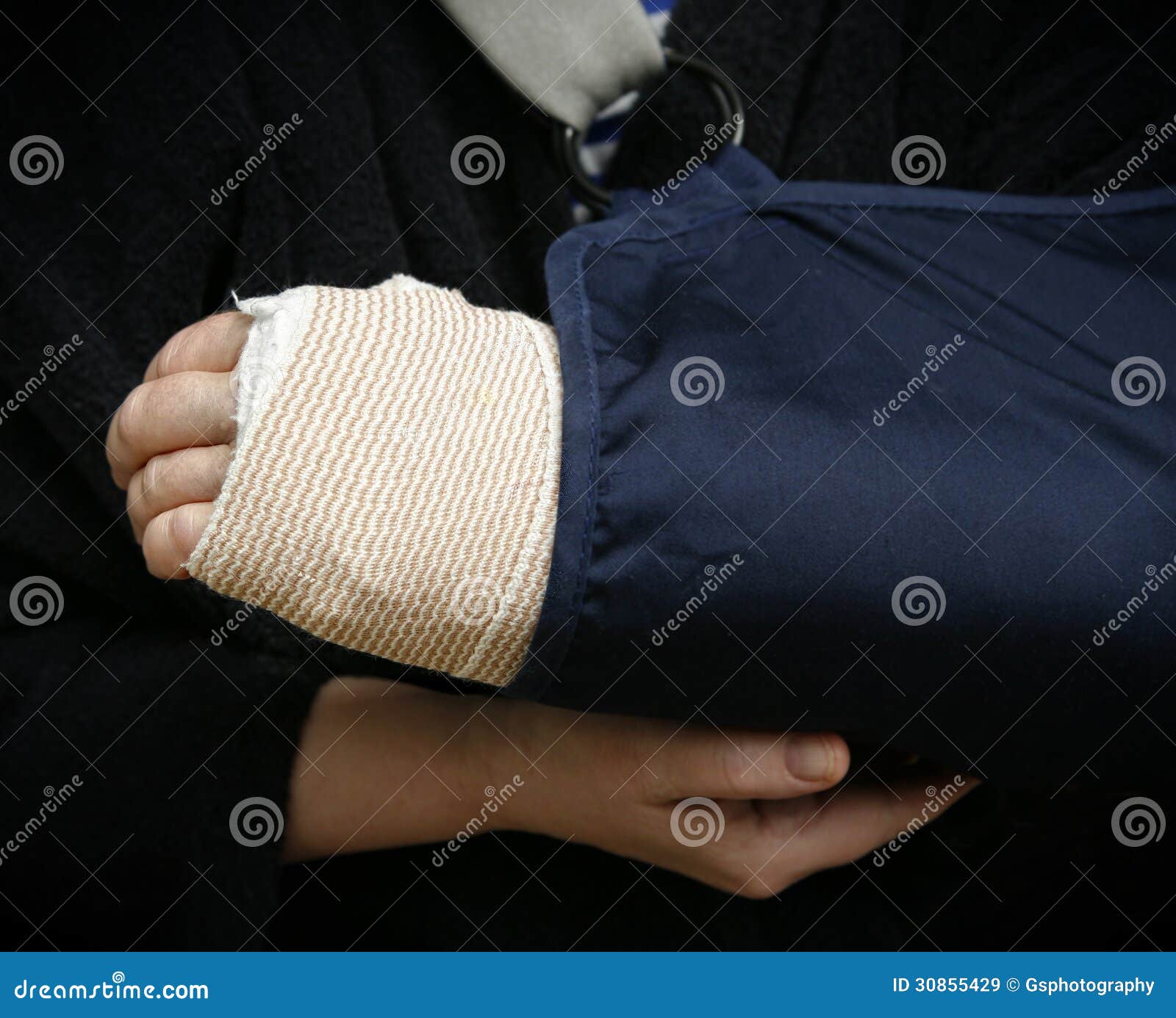 Gebrochener Arm stockbild. Bild von zerbrochen, gips - 30855429