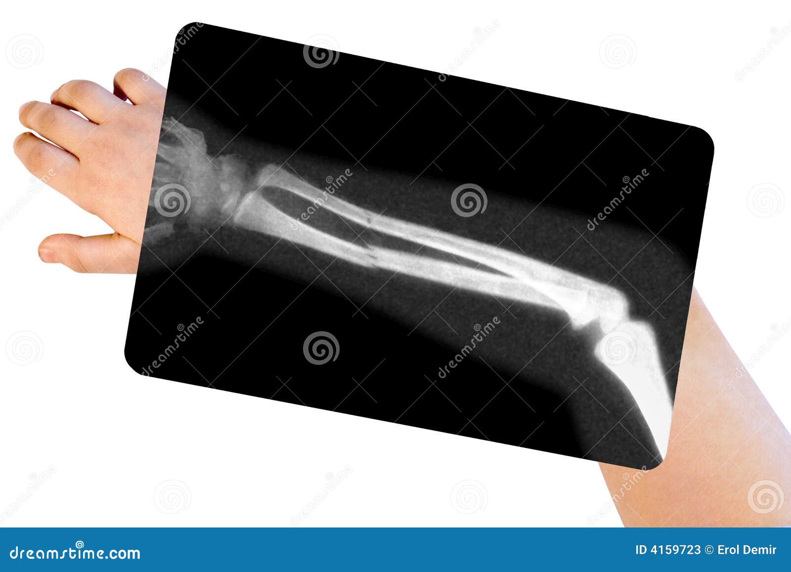 Gebrochener Arm stockbild. Bild von wissenschaft, orthopädisch - 4159723