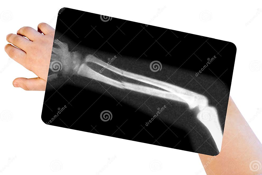 Gebrochener Arm stockbild. Bild von wissenschaft, orthopädisch - 4159723