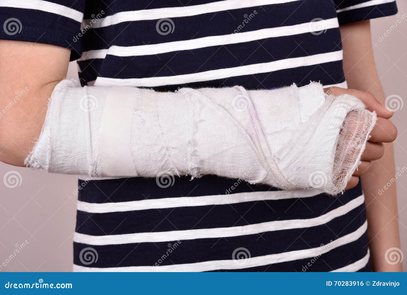 Gebrochener Arm stockfoto. Bild von fallen, gips, orthopädisch - 70283916