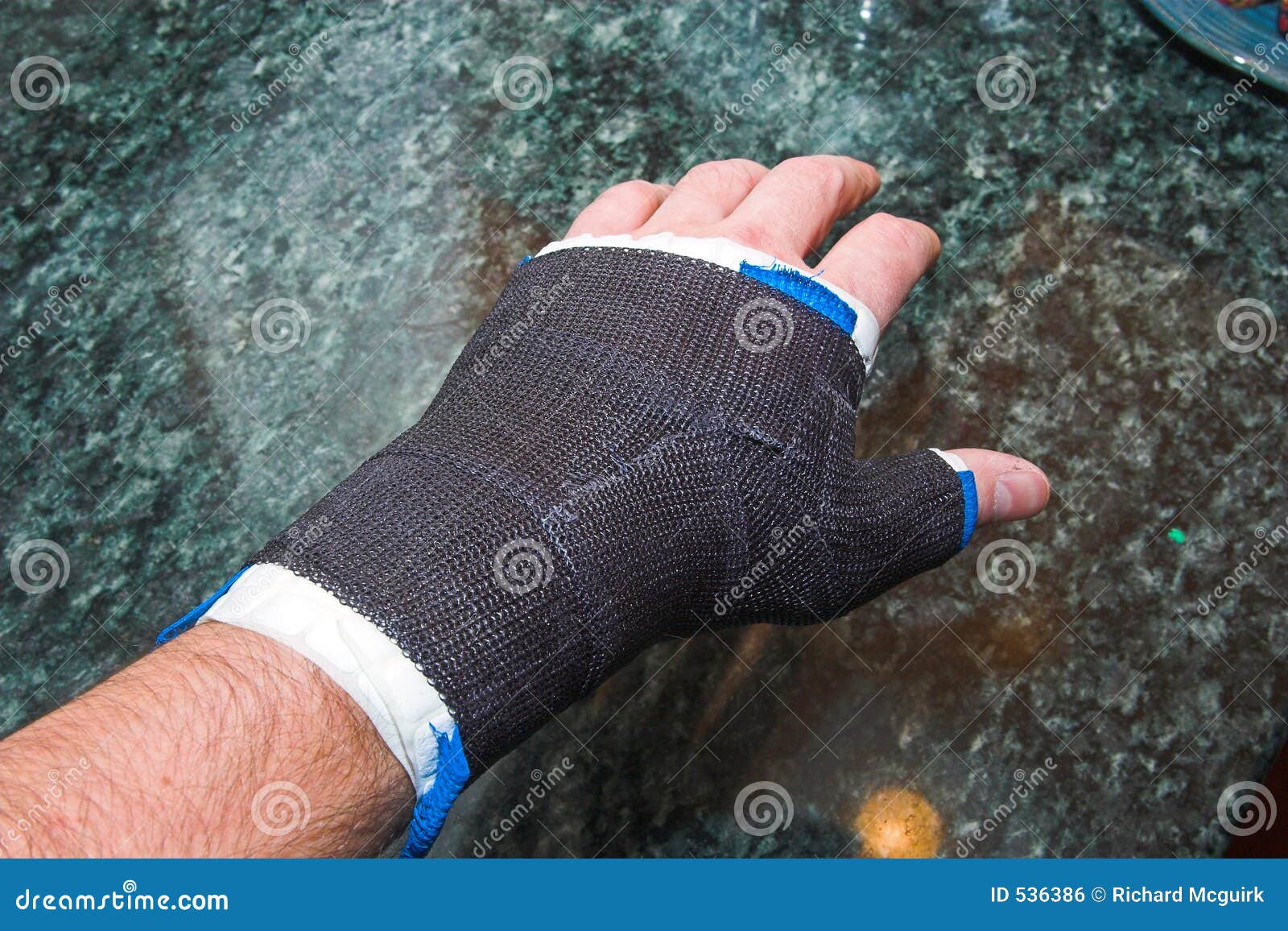 Gebrochener Daumen stockfoto. Bild von unfall, krank, heilen - 536386