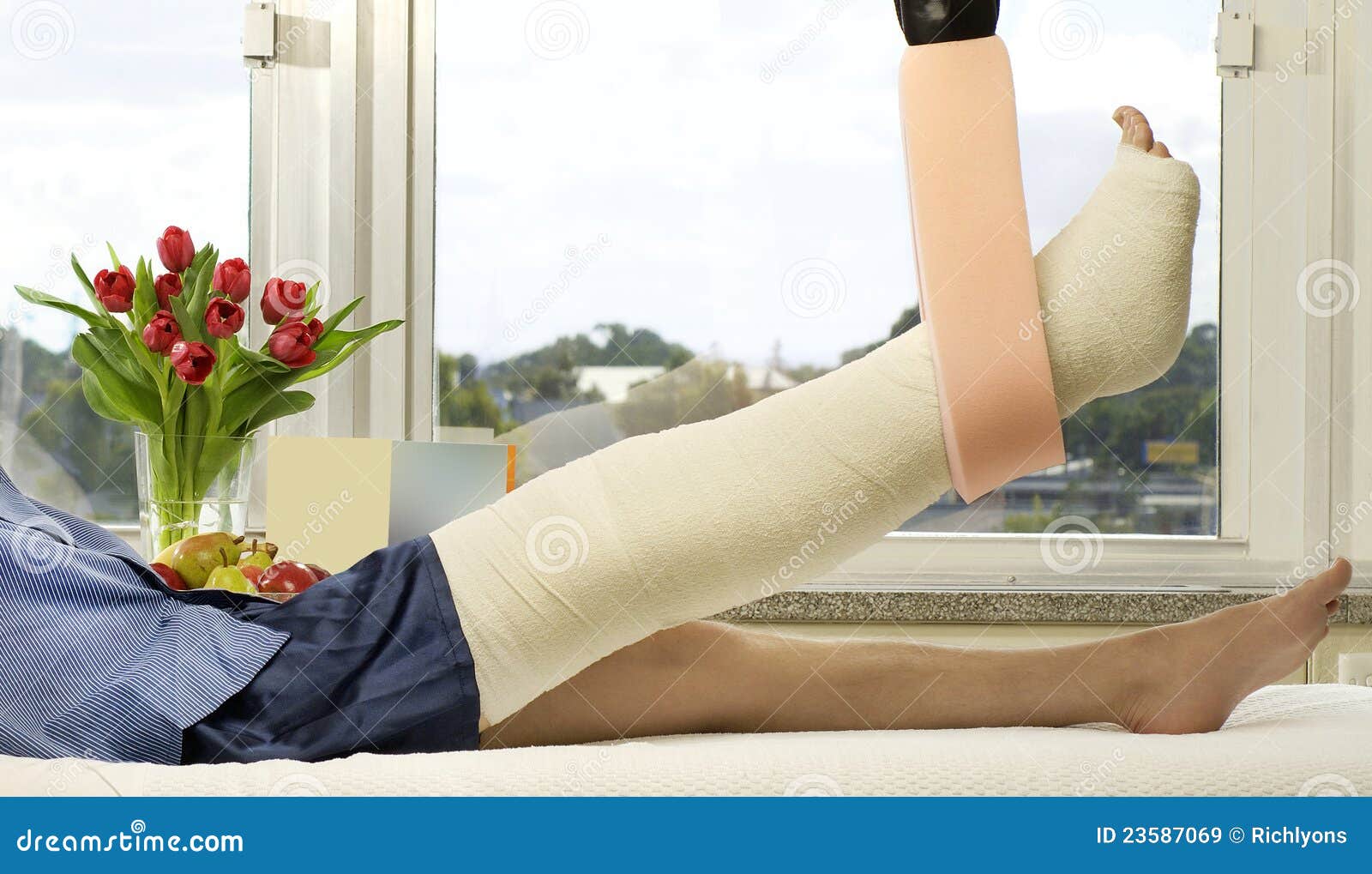 Gebroken Been stock afbeelding. Image of binnen, verwonding - 23587069