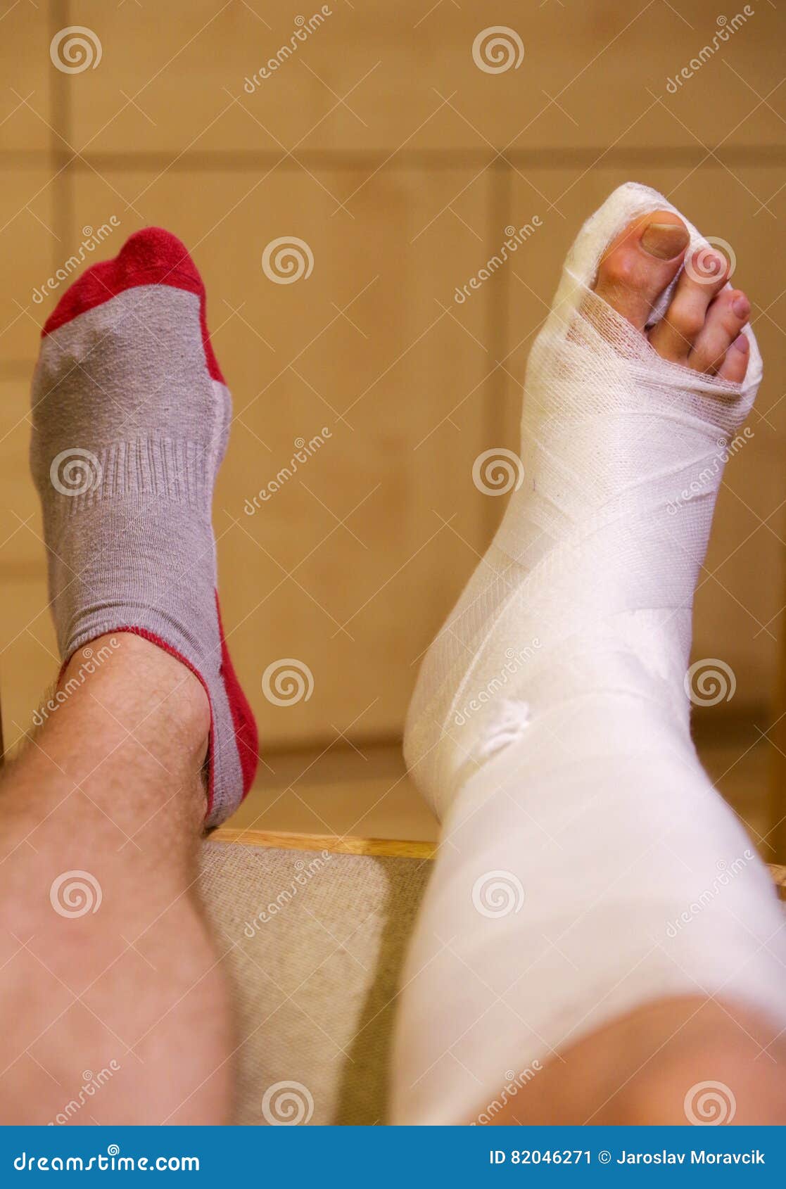 Gebroken been in gips stock afbeelding. Image of splinter - 82046271