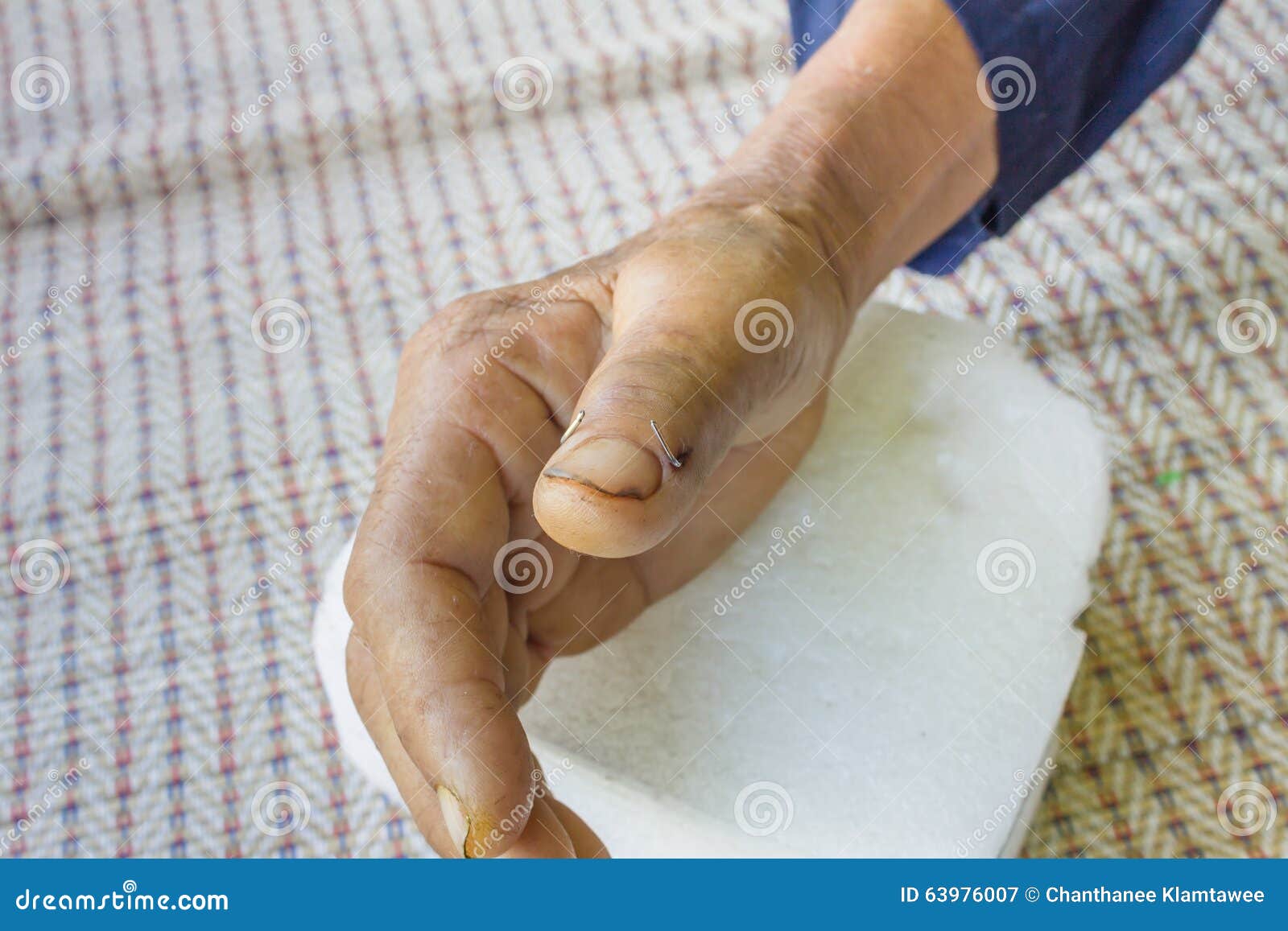 Gebroken Duim stock afbeelding. Image of cijfer, schade - 63976007