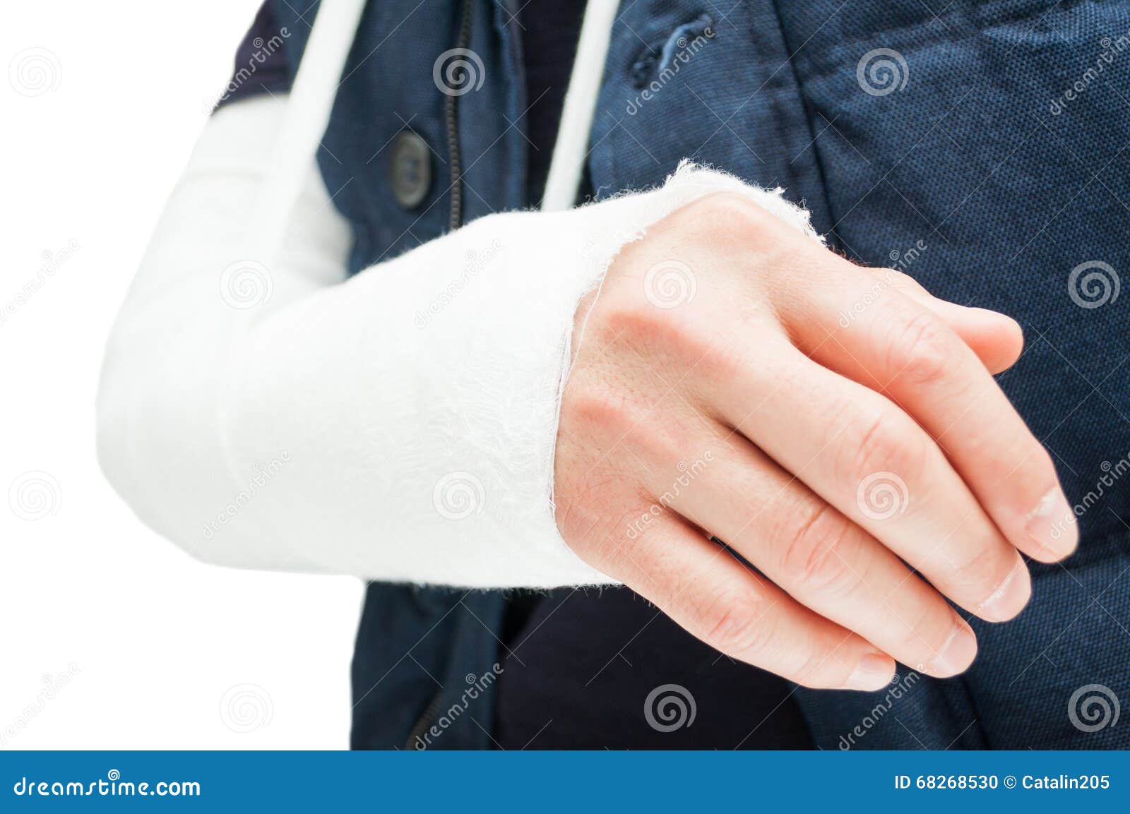 Gebroken Elleboog Met Medisch Verband of Gips Stock Foto - Image of ...