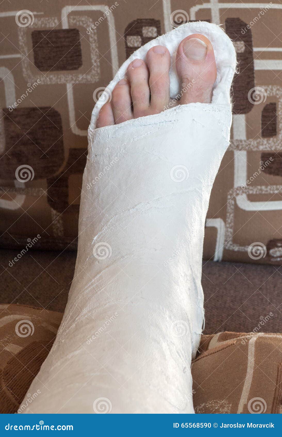 Gebroken enkel in gips stock foto. Image of sport, been - 65568590