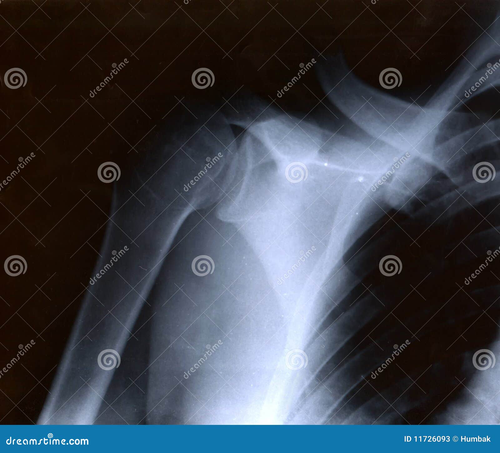 Gebroken sleutelbeen stock afbeelding. Image of stekel - 11726093