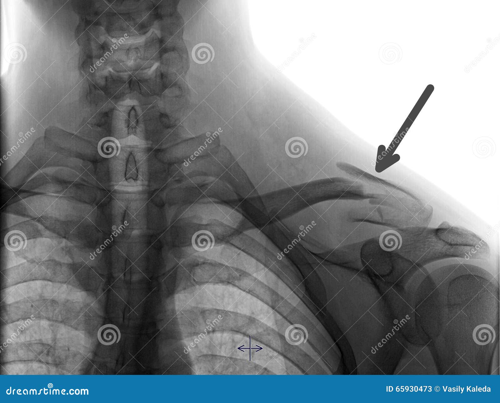 Gebroken sleutelbeen stock afbeelding. Image of medisch - 65930473