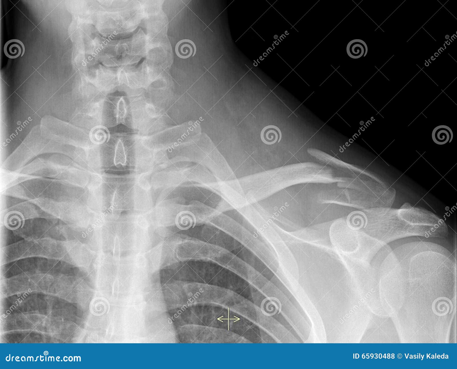 Gebroken sleutelbeen stock foto. Image of trauma, kraag - 65930488