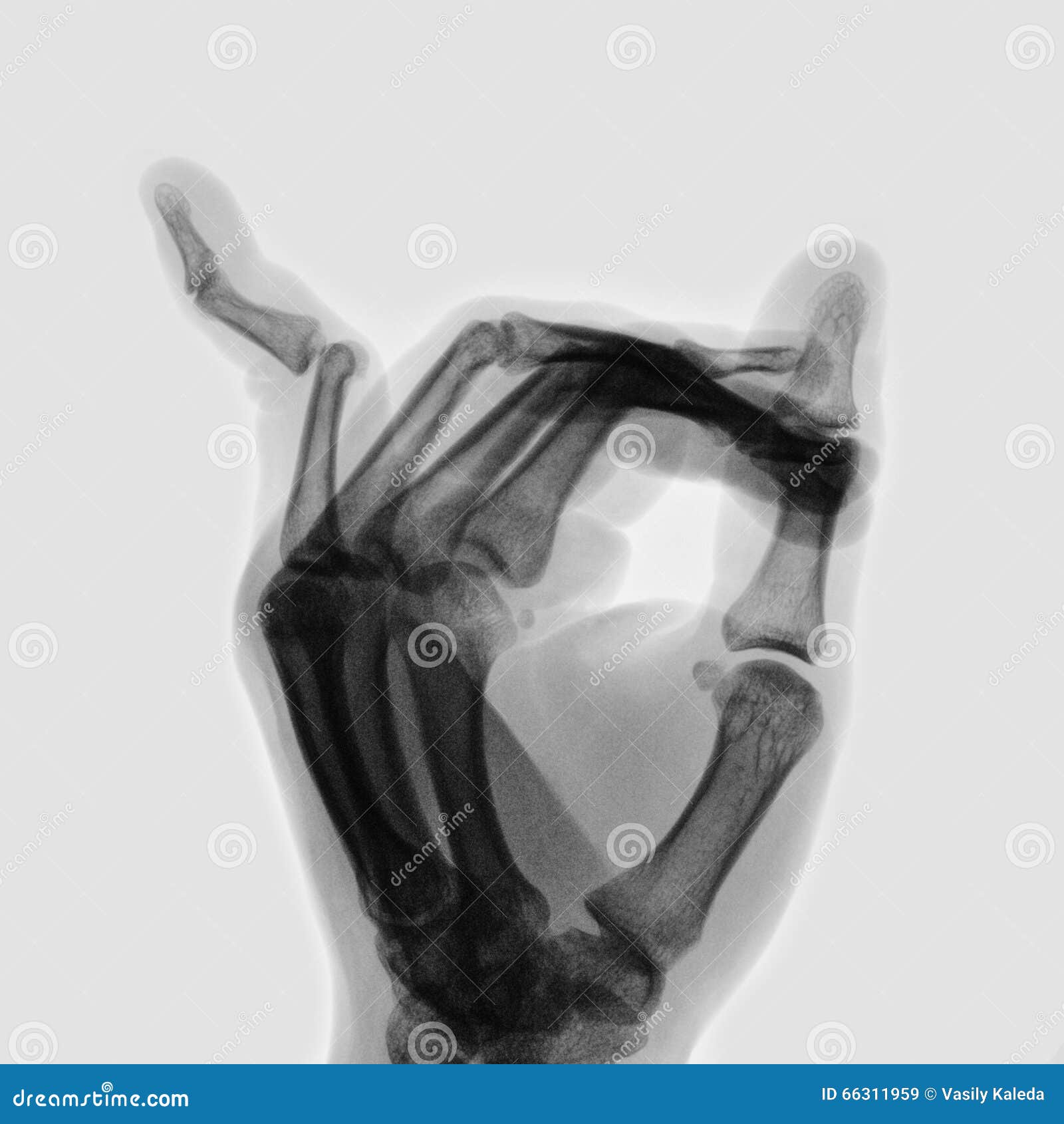 Gebroken Vinger stock afbeelding. Image of röntgen, voorarm - 66311959