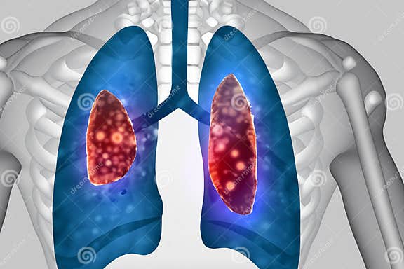 Lungs. Pertussis. Whooping Cough. Bordetella Pertussis. Lungs with ...