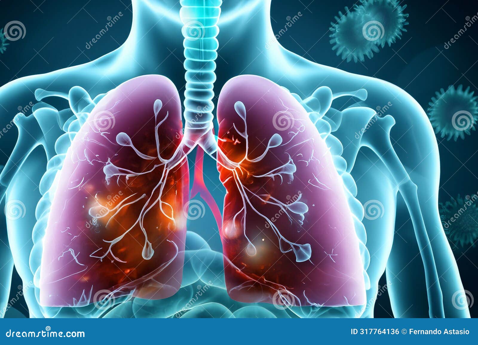 Lungs. Pertussis. Whooping Cough. Bordetella Pertussis. Lungs with ...