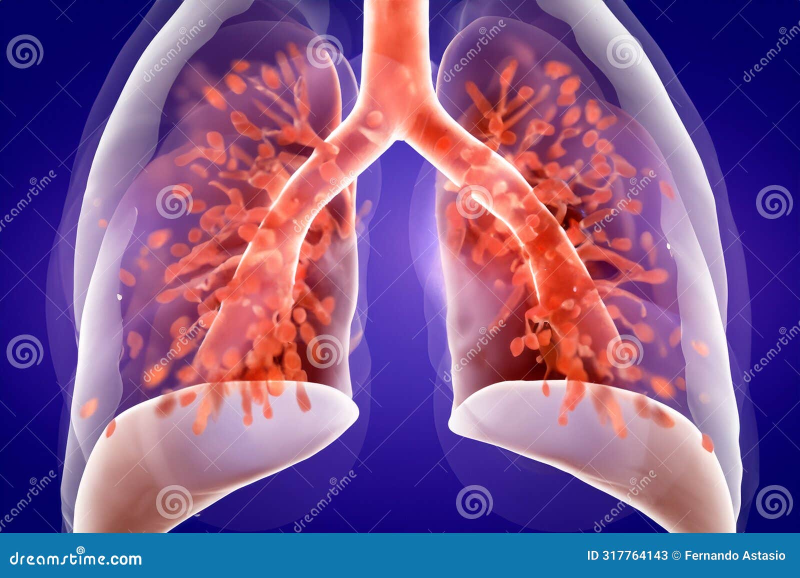 Lungs. Pertussis. Whooping Cough. Bordetella Pertussis. Lungs with ...