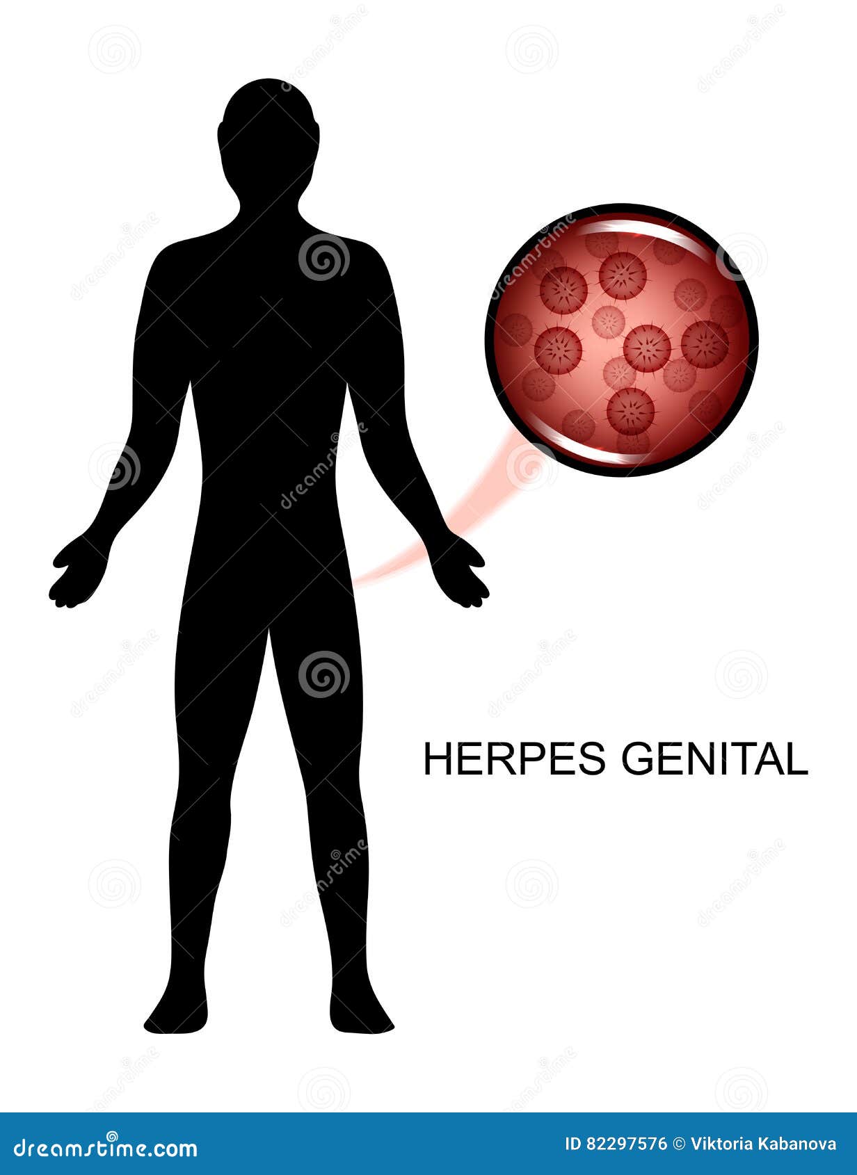 Genitaler Herpes Des Virus in Den Menschen Vektor Abbildung ...