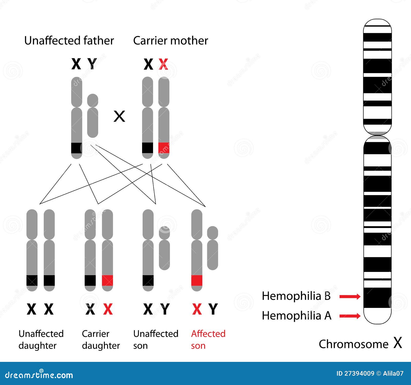 Genética De La Hemofilia Ilustración Del Vector Ilustración De
