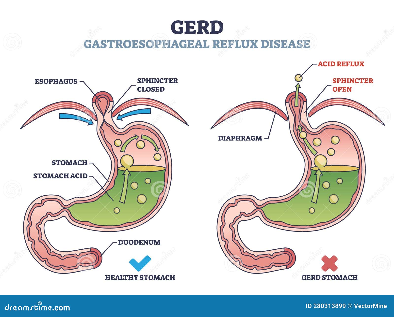 Gerd Or Gastroesophageal Reflux Disease With Digestive Acid Outline