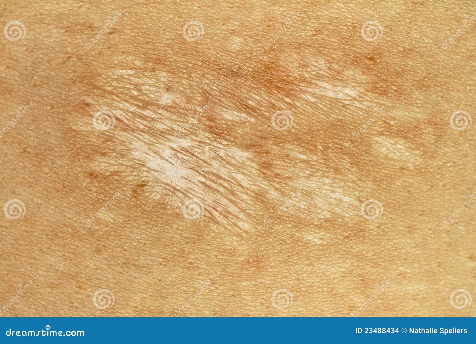 German Sheppard Dog Bite Scar Stock Photo - Image of bite, mark: 23488434