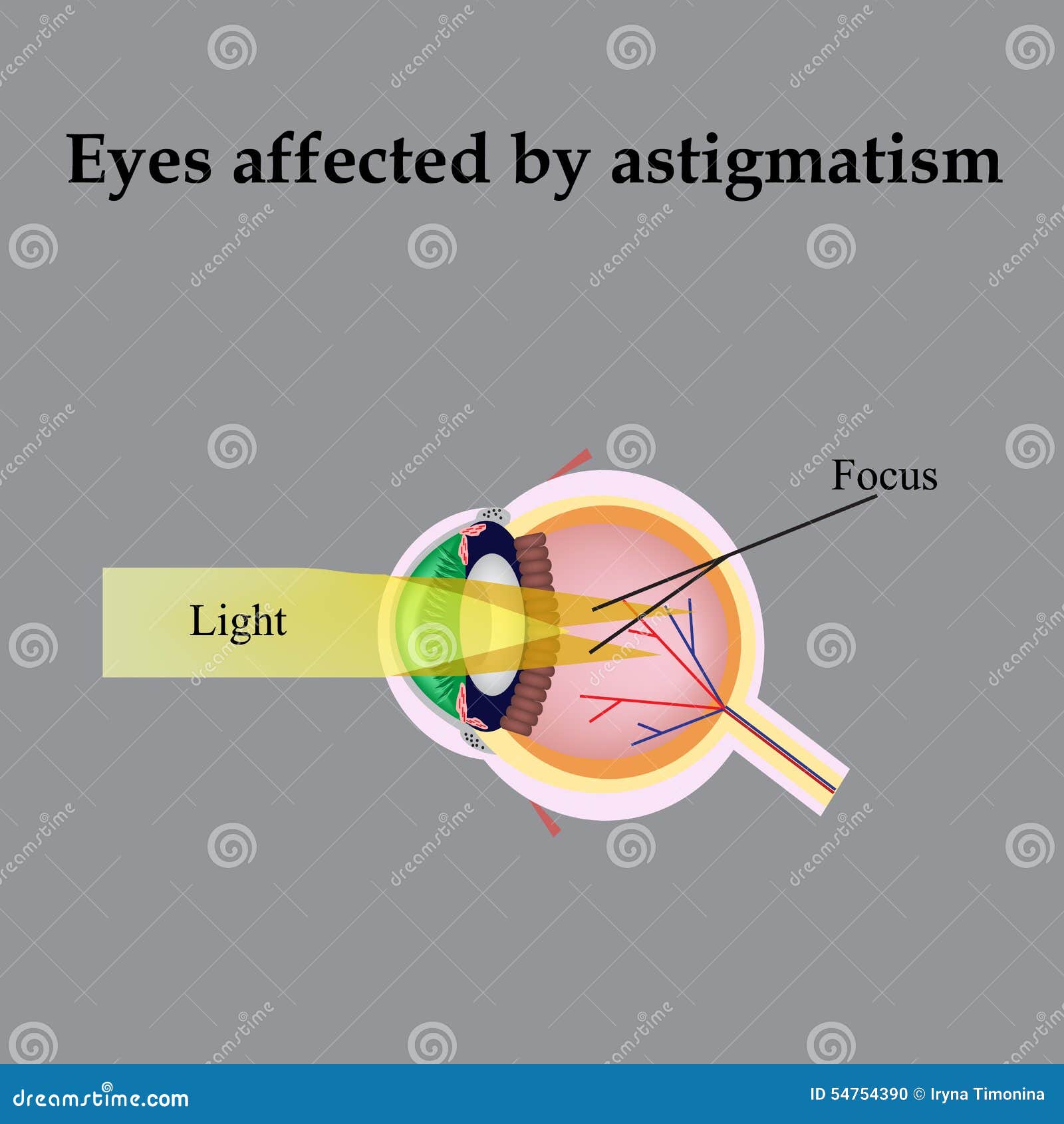 Geschade Visie Met Astigmatisme Als Astigmatisme Vector Illustratie ...