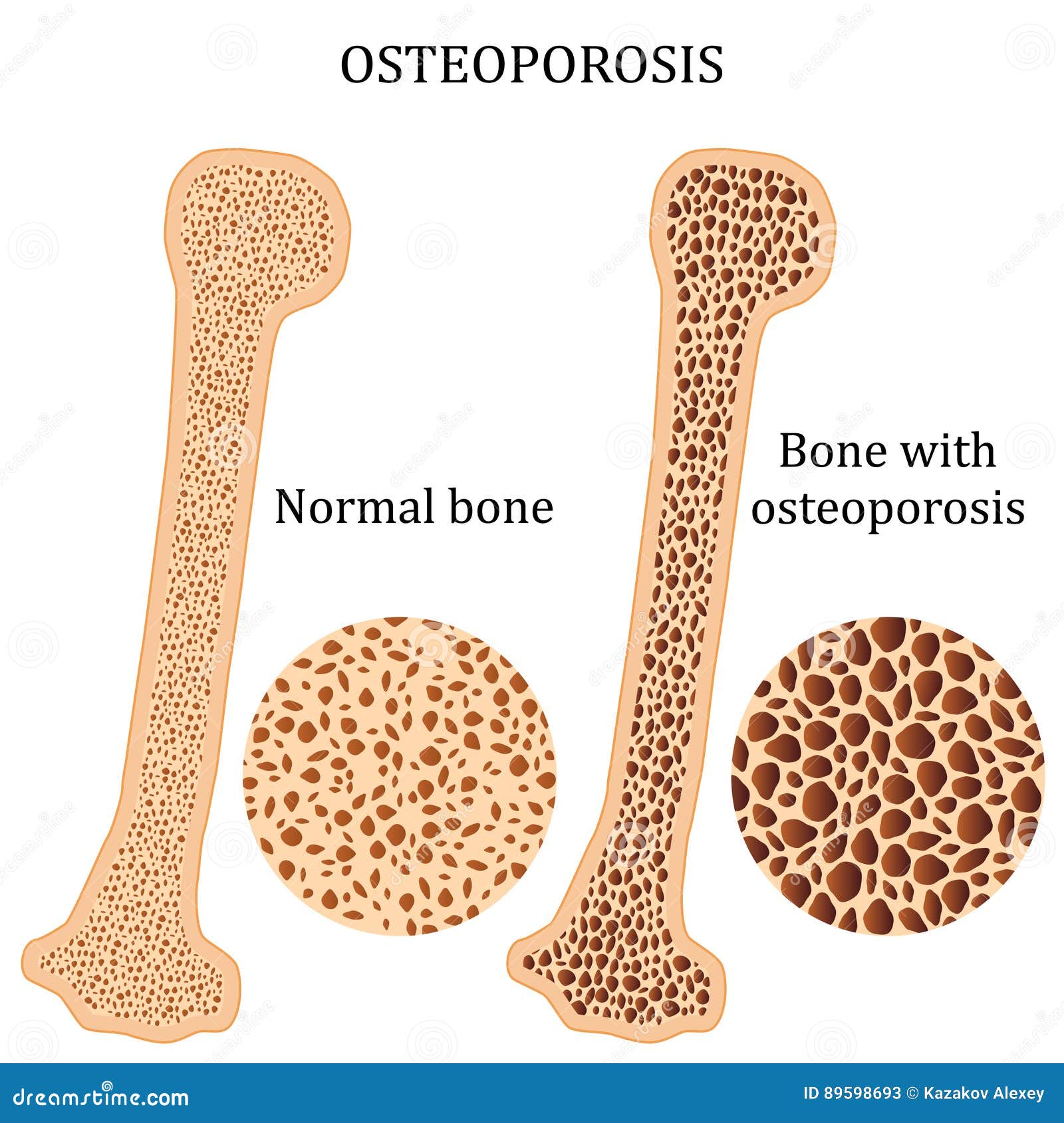 Gesunder Knochen Und Osteoporoseknochen Vektor Abbildung - Illustration ...