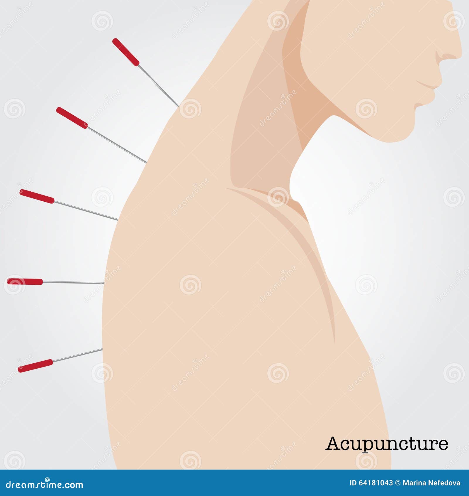 Getting Acupuncture Treatment. Stock Illustration - Illustration of ...