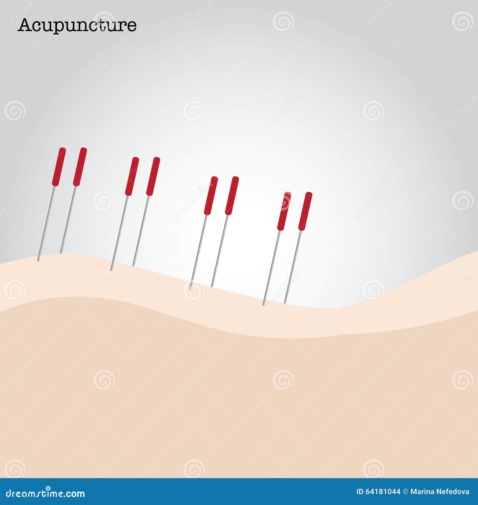 Getting Acupuncture Treatment. Stock Illustration - Illustration of ...
