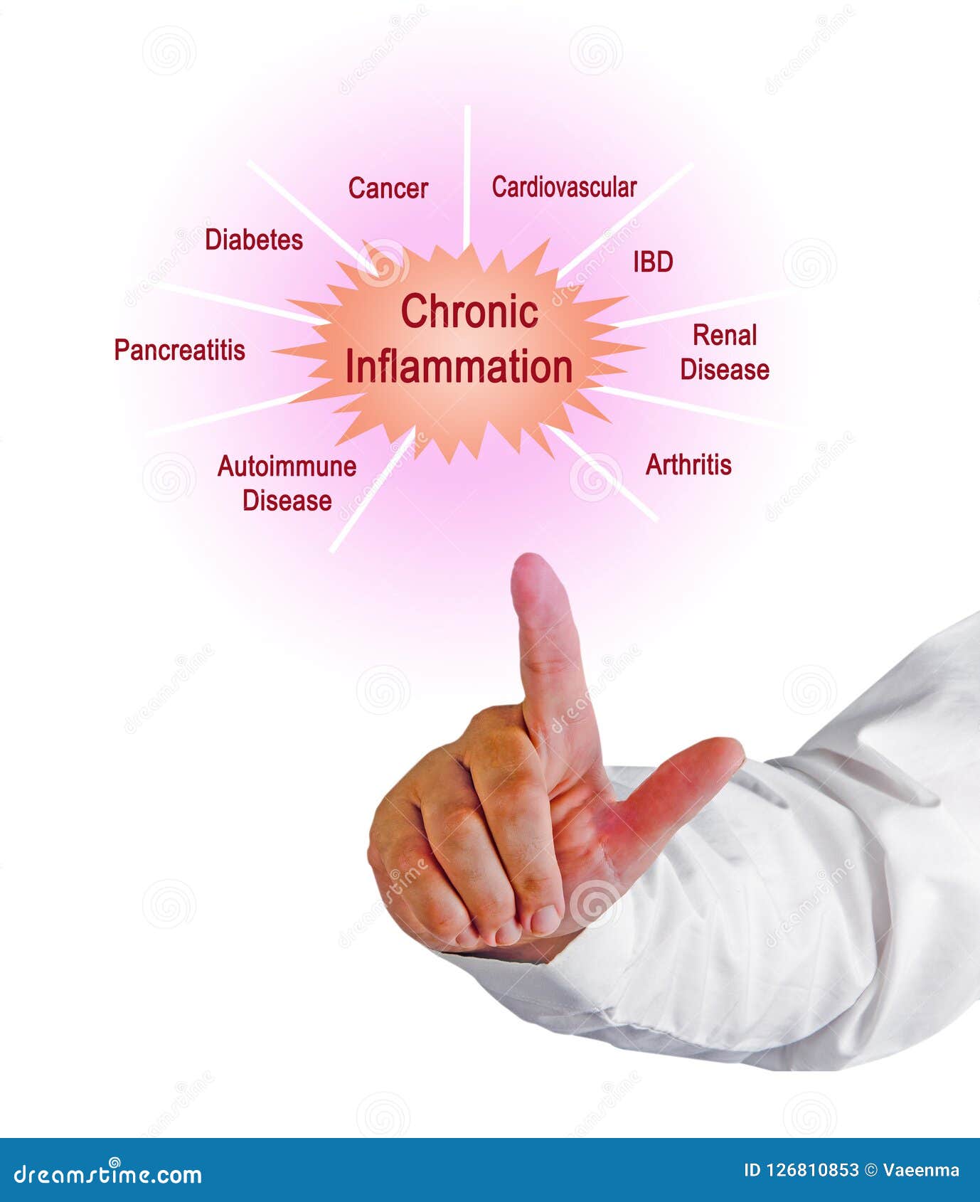 Gevolgen Van Chronische Ontsteking Stock Afbeelding - Image of mens ...